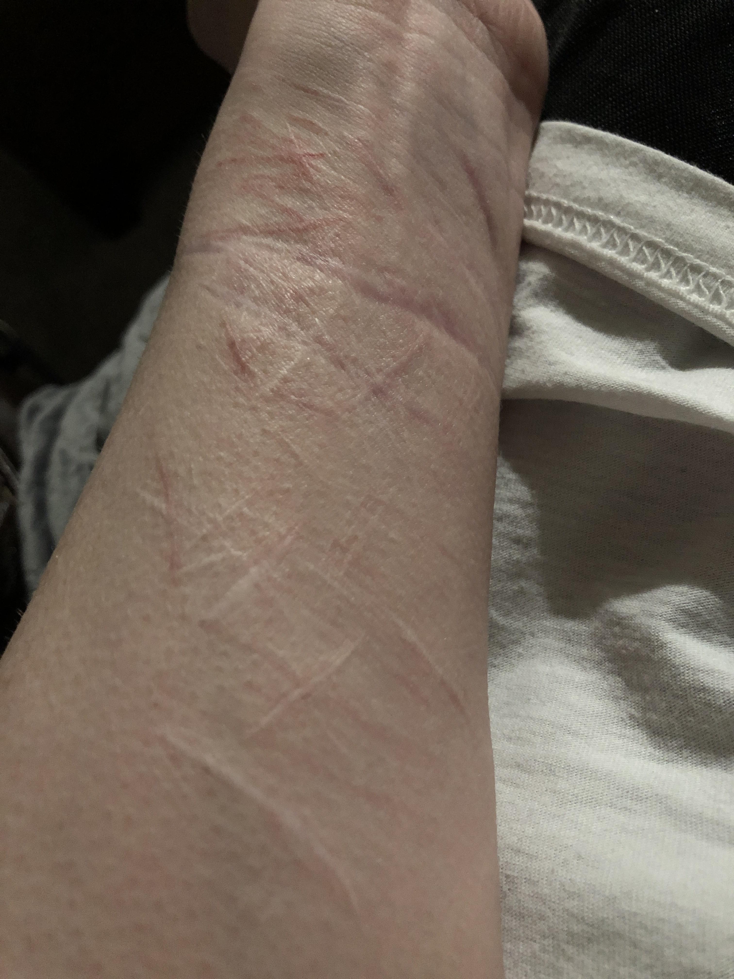 Too much scar tissue to cut anymore :sad face: | Scrolller