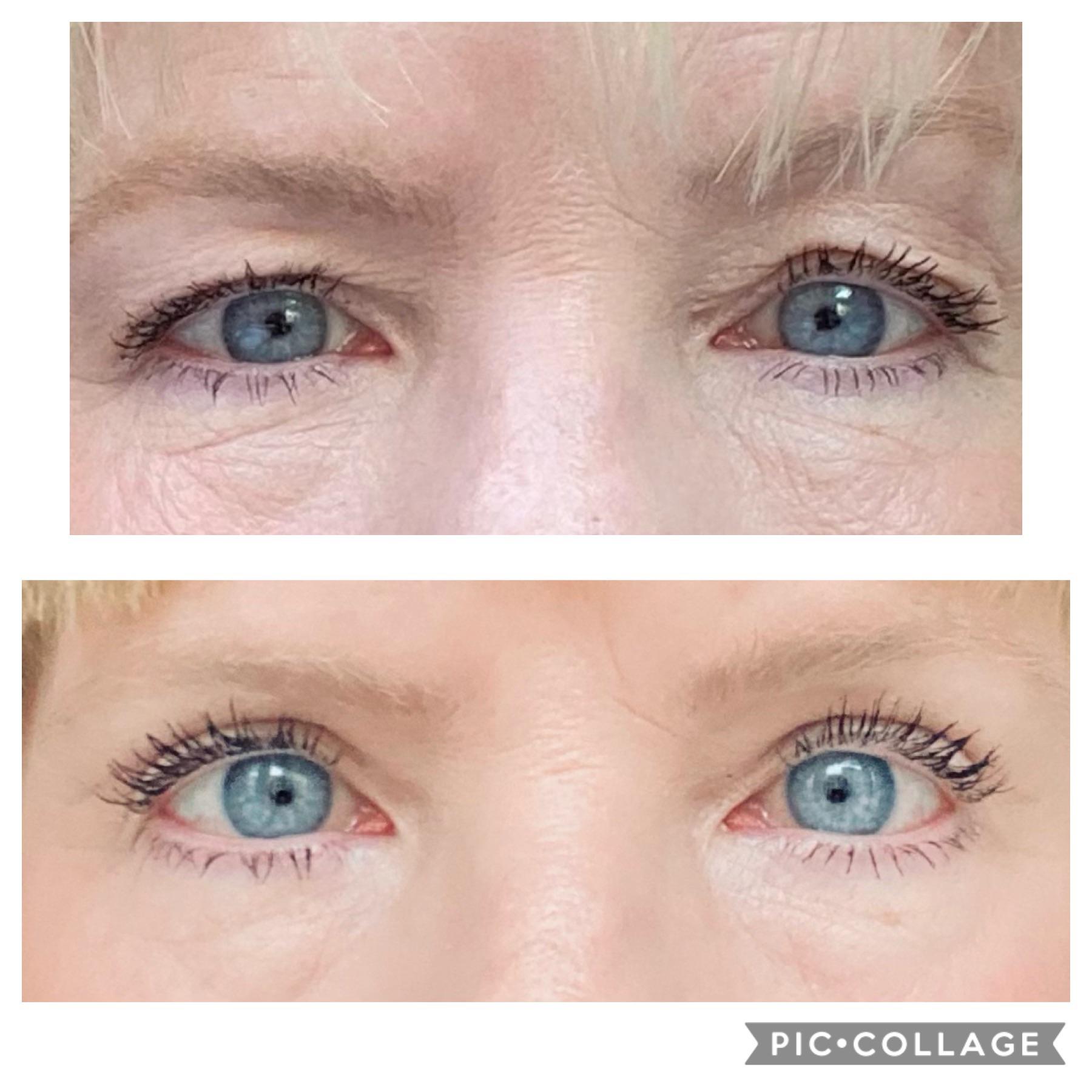 Upper Bleph: before and 8 weeks post-op | Scrolller