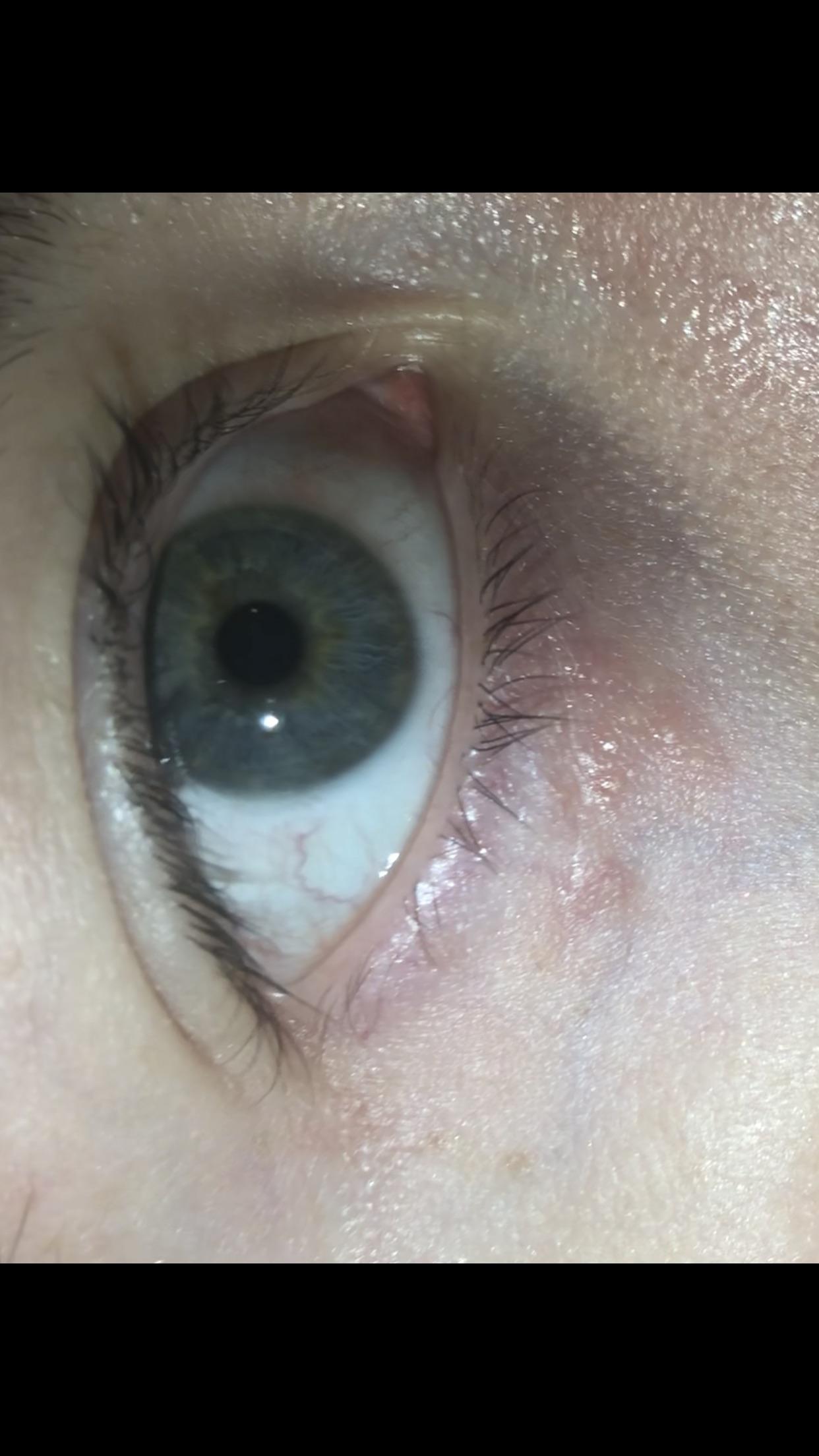 Weird eye bumps??? | Scrolller