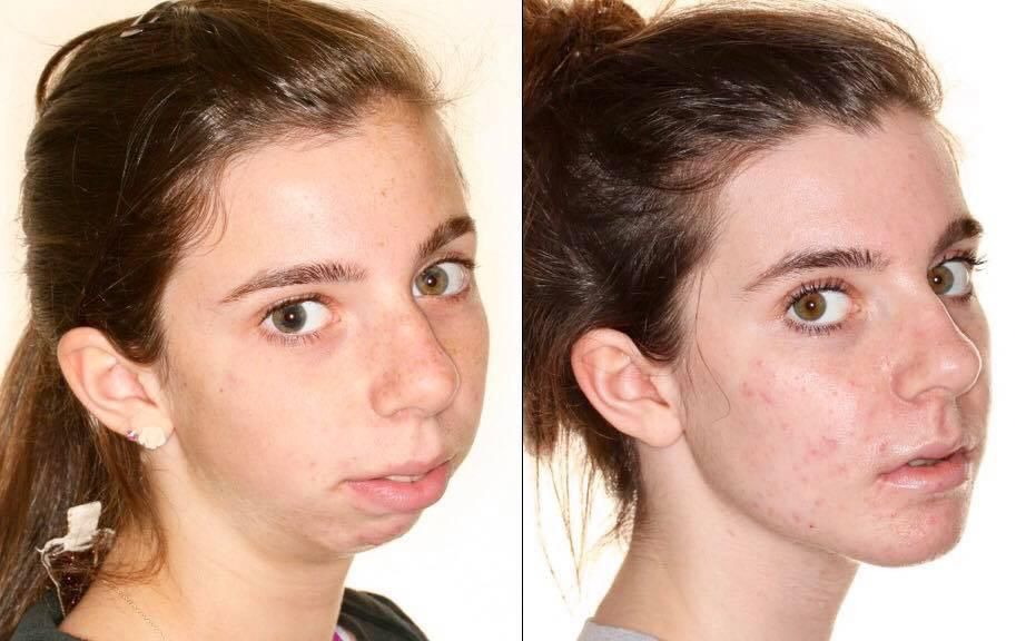 Before After Orthognathic Surgery | Scrolller