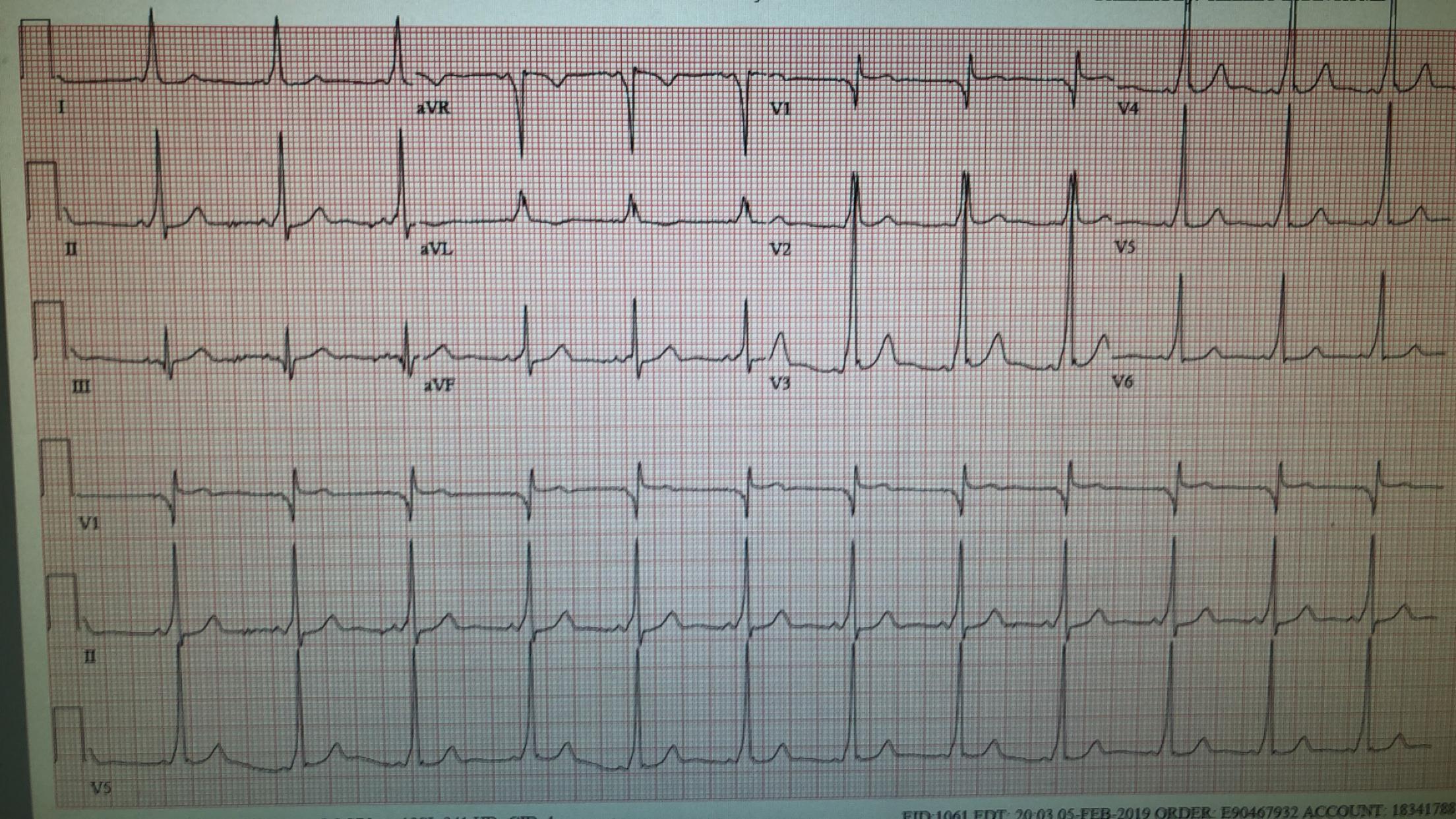 Wpw Type A Pattern Scrolller