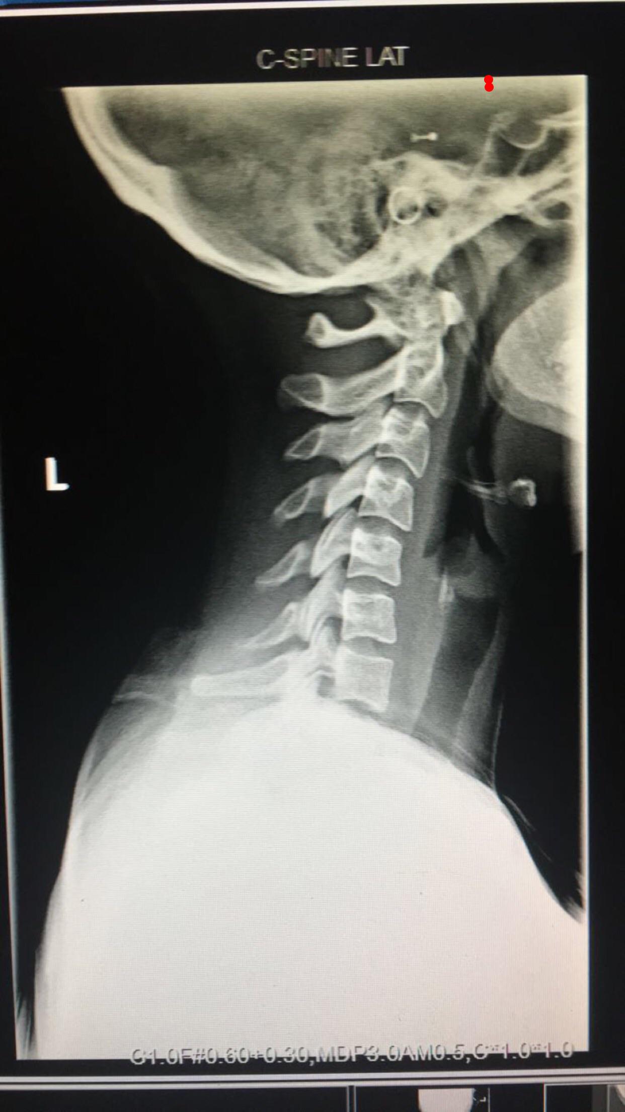 X-Ray of my neck 🧐 | Scrolller