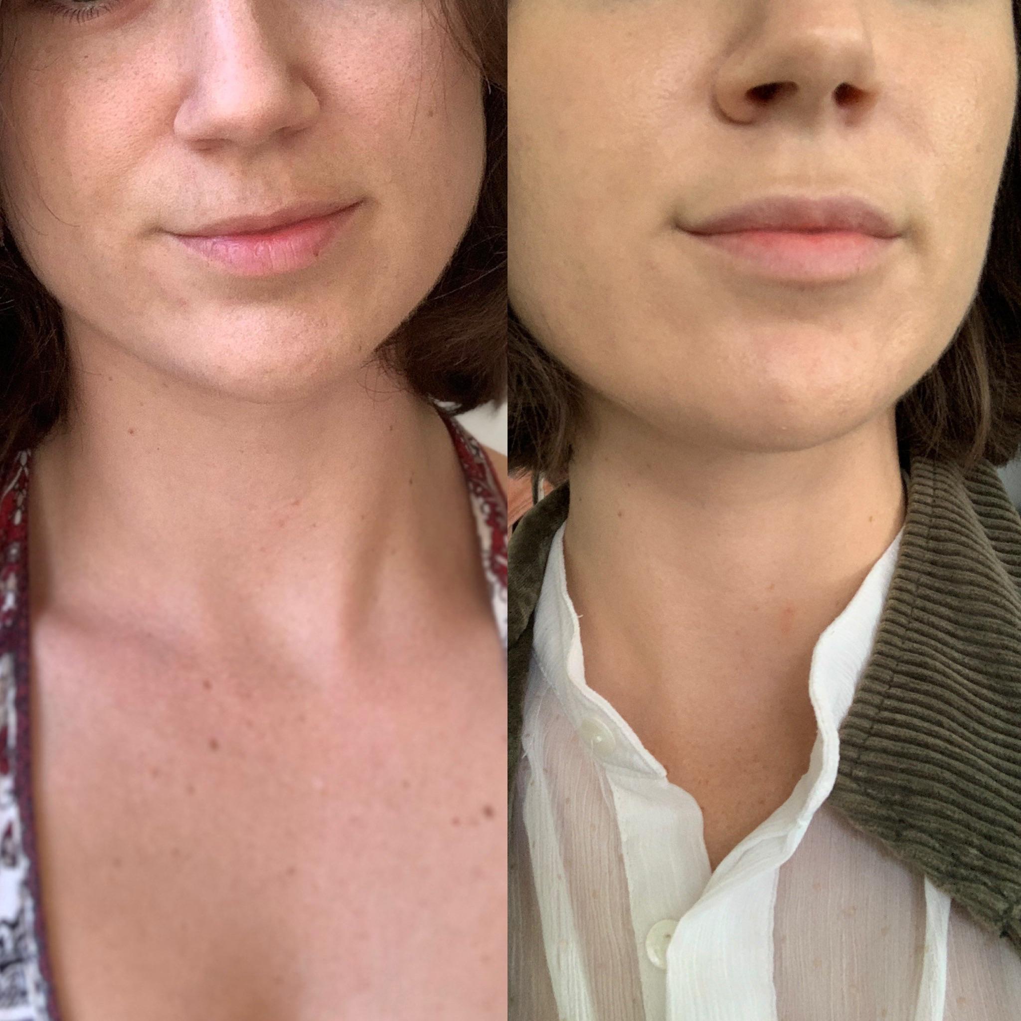 1/2 a syringe of Juvederm Ultra and two units of botox above upper lip for a lip flip. Photo on ...