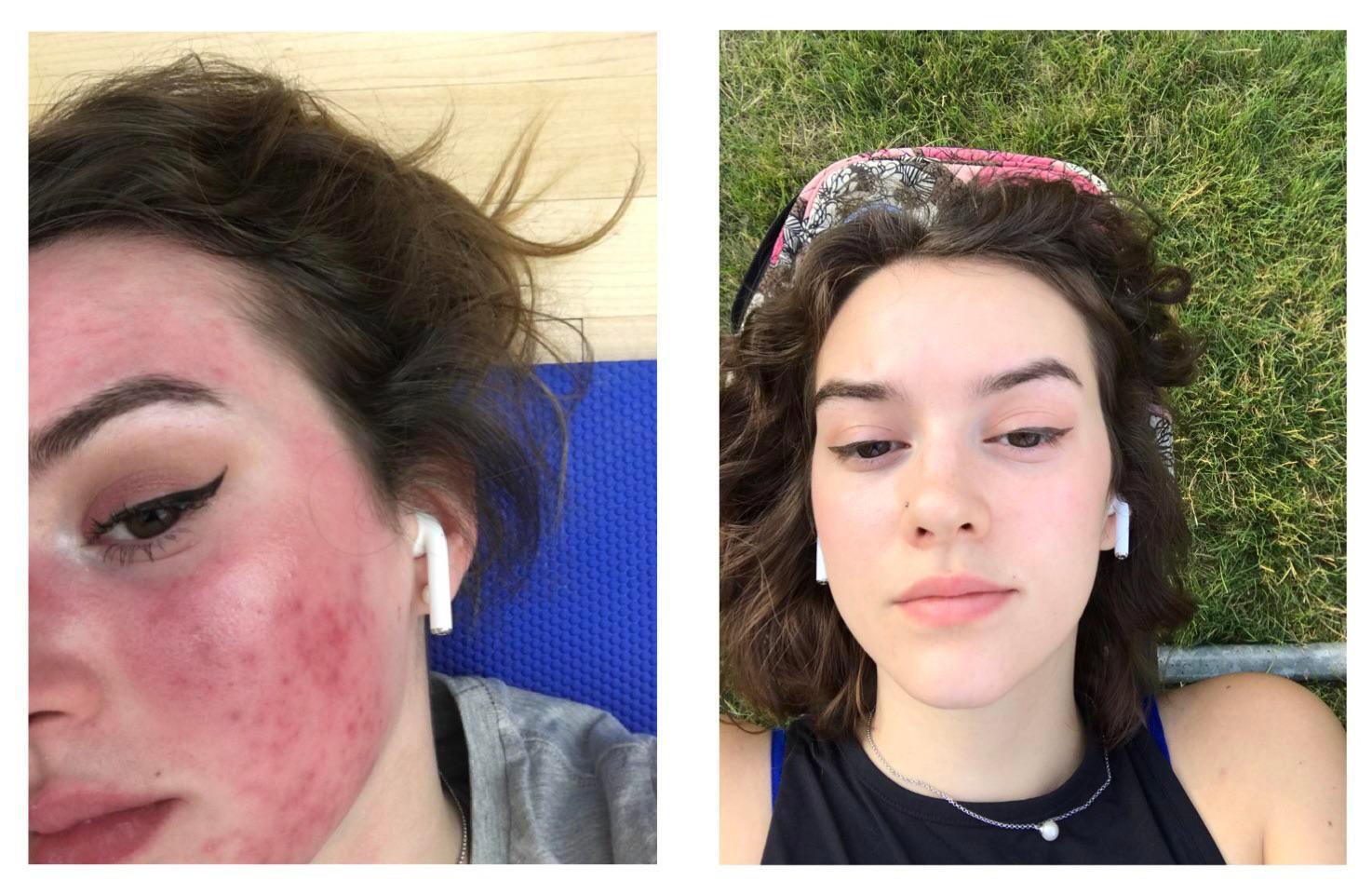 1.5 yr difference on PIH/PIE and general redness! | Scrolller