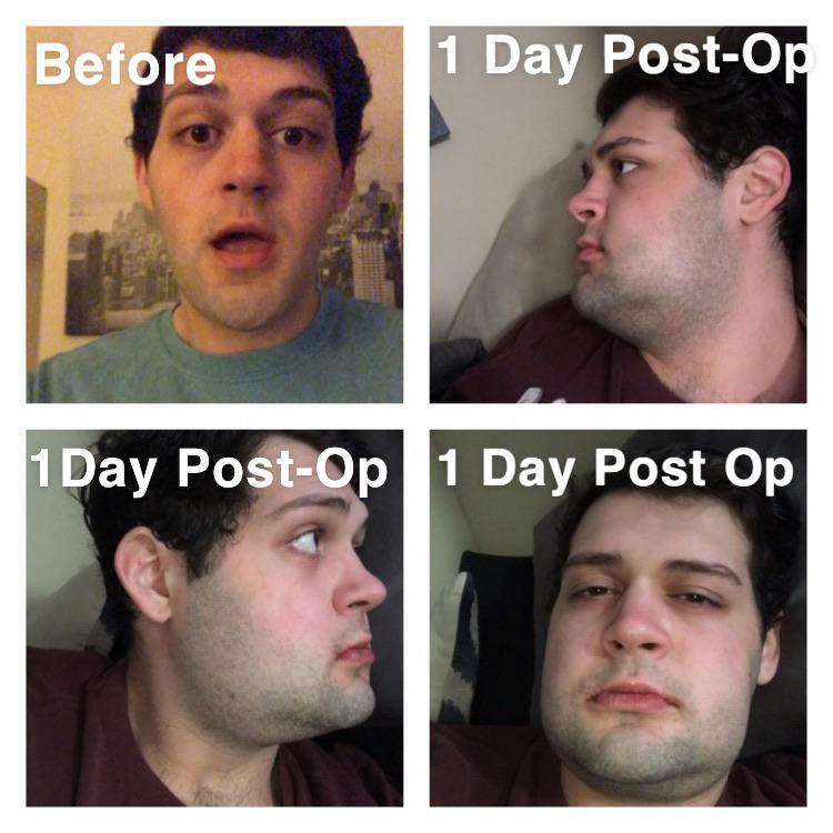 1 Day Post-Op, I’m miserable :( | Scrolller