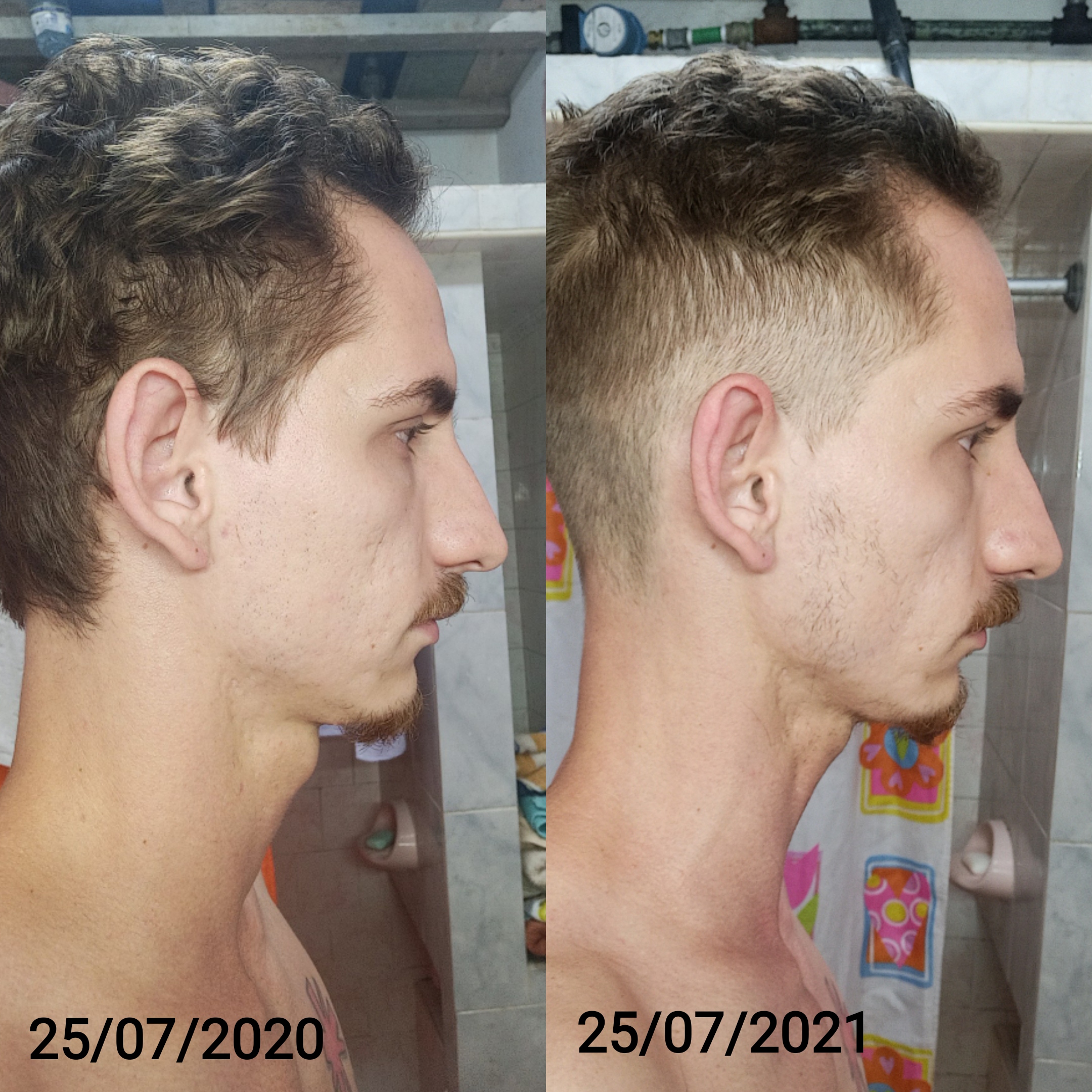 1 year mewing. 27 years old, side photo | Scrolller