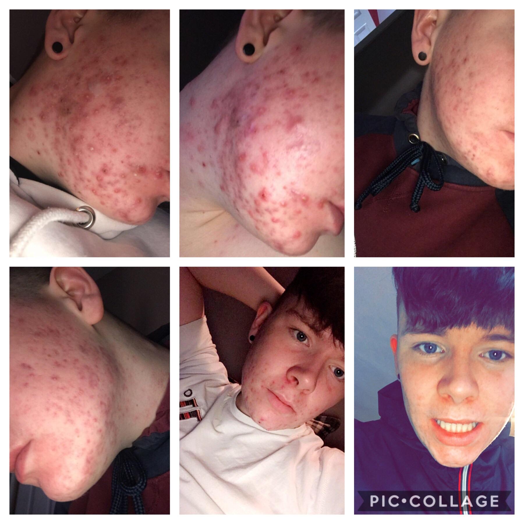 2 months difference | Scrolller