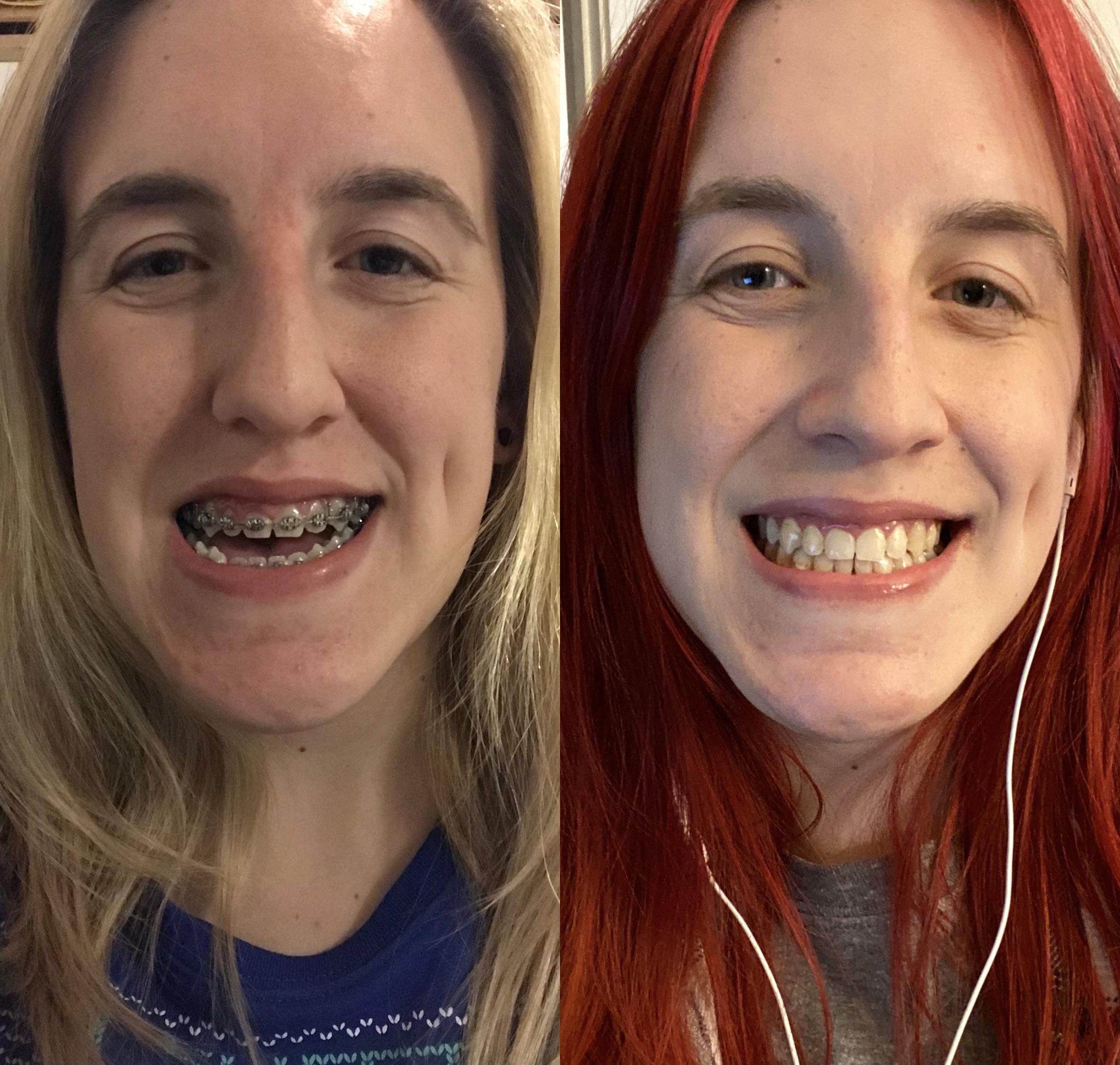 2 years post op - DJS & genio | Scrolller