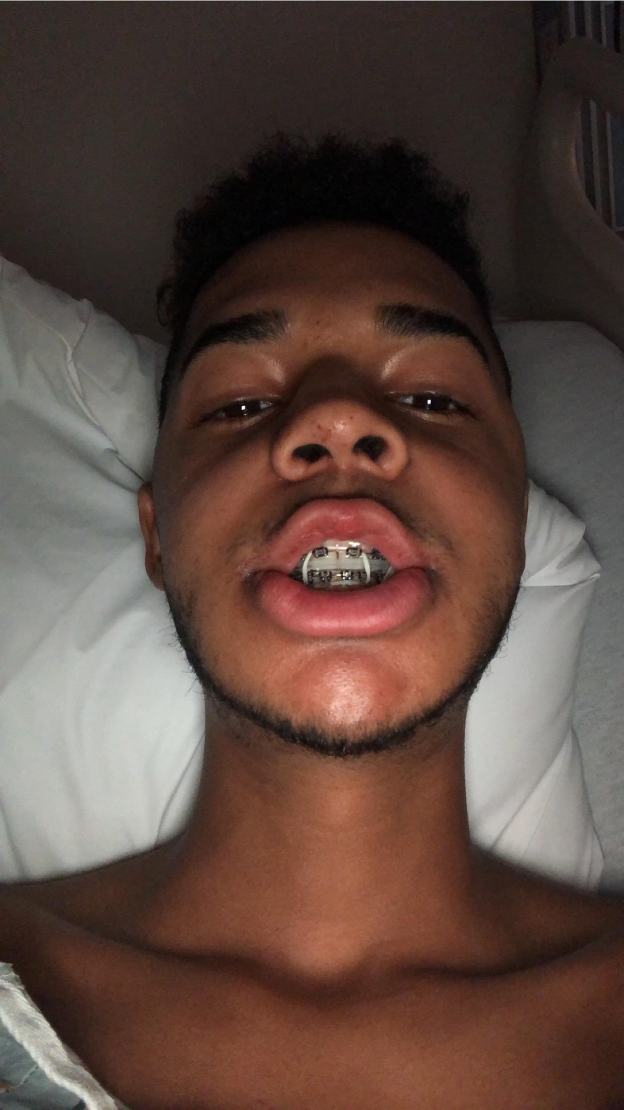 20 hours post op 🤧 | Scrolller