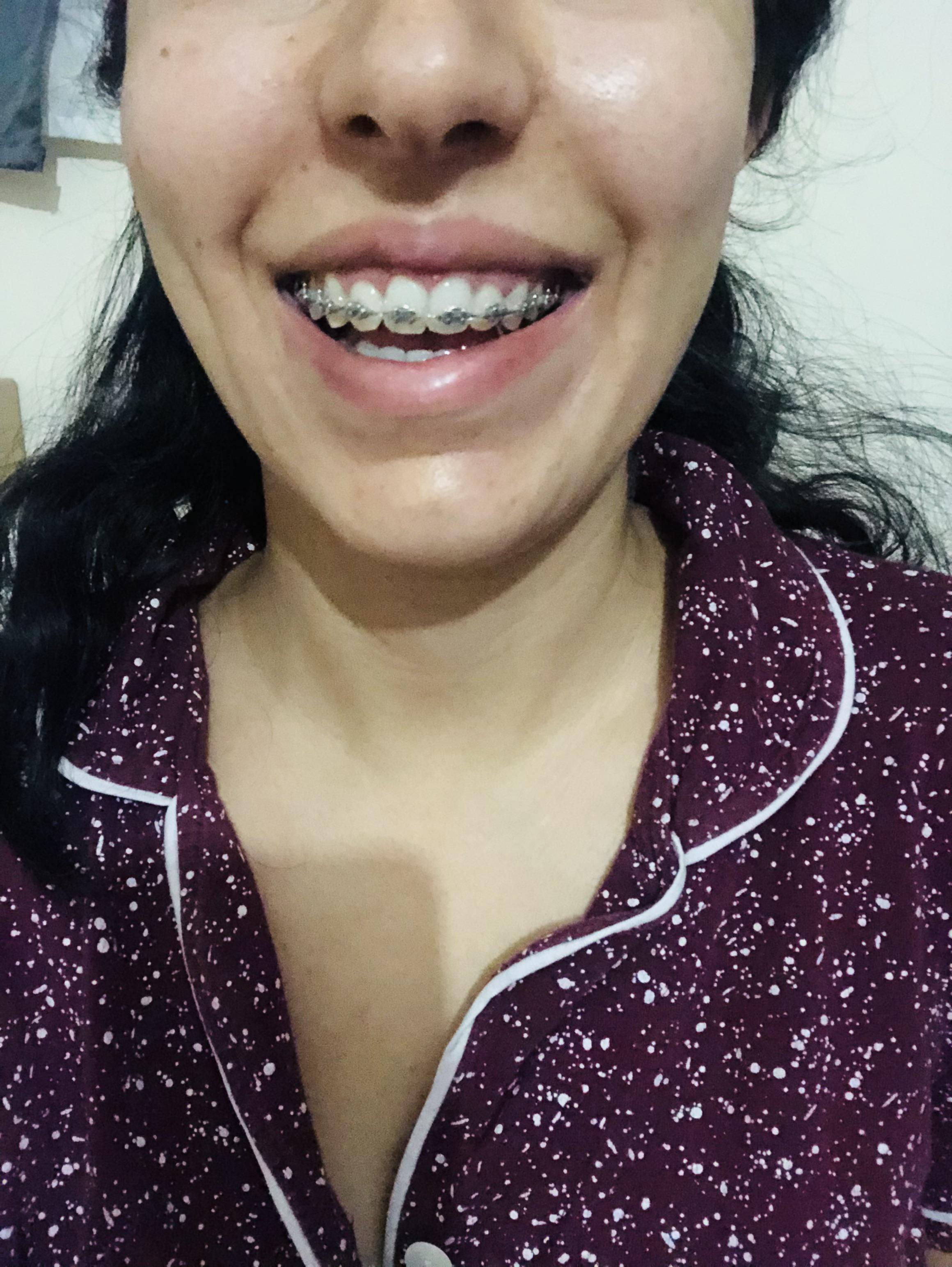 20. month passed. But i am not satisfied yet. I think top ones not straight enough and i always ...