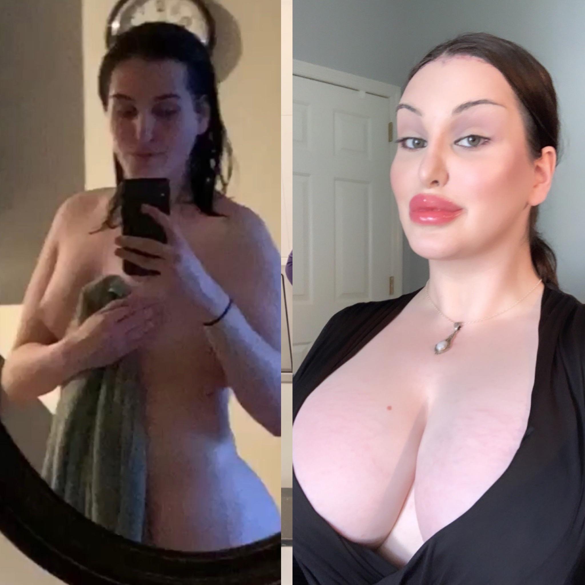 3 years On HRT + Plastic Surgery Does A Body Good! (1st year On HRT -> Current) | Scrolller