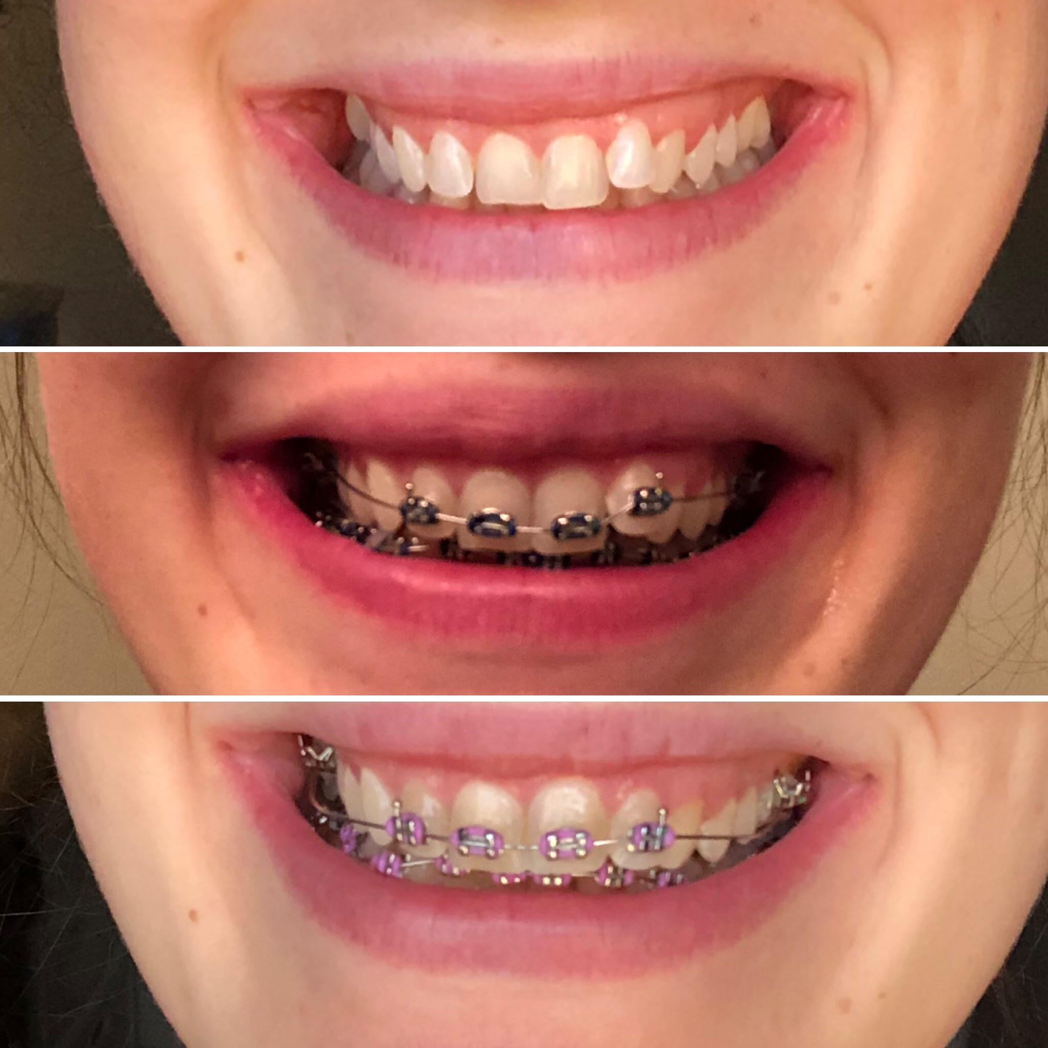 (30 y/o F) 1.5 month progress - no more snaggle tooth! more info in comments. | Scrolller