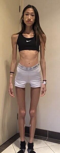 30kg/BMI 10 | Scrolller