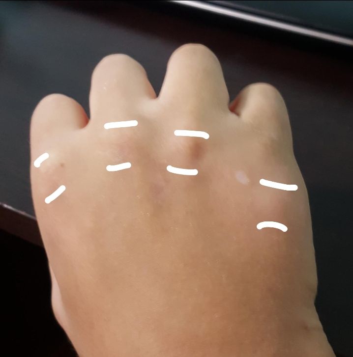 4 weeks ago I broke my pinky bone . The fracture is called "Boxer Fracture". I had my hand ...