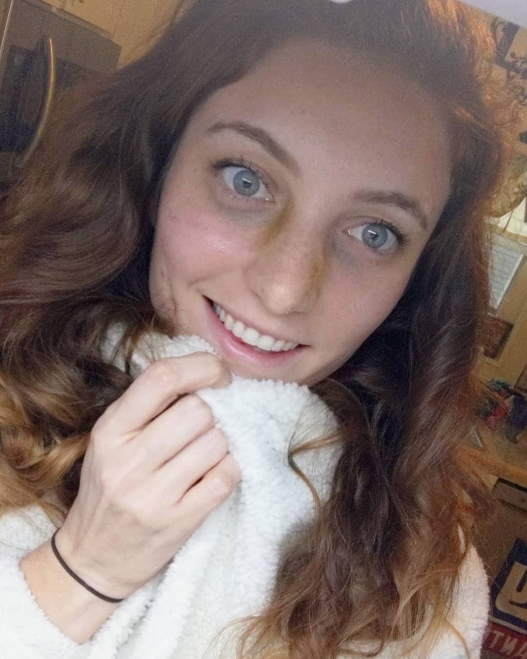 7 days post op from sinus reconstruction and my eyes are almost back to normal | Scrolller