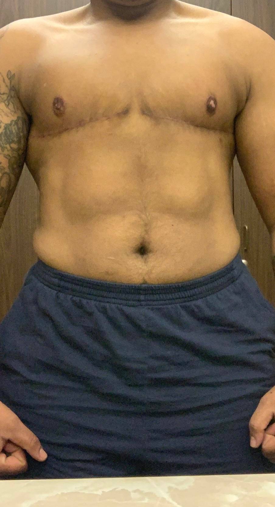 8 weeks Post Op | Scrolller