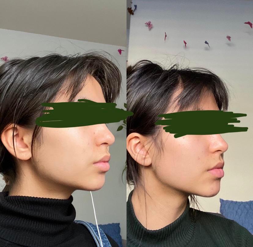About 1.5 month difference for Cherry Sub’s RFU jaw and face fat sub/ideal face, I think there’s ...
