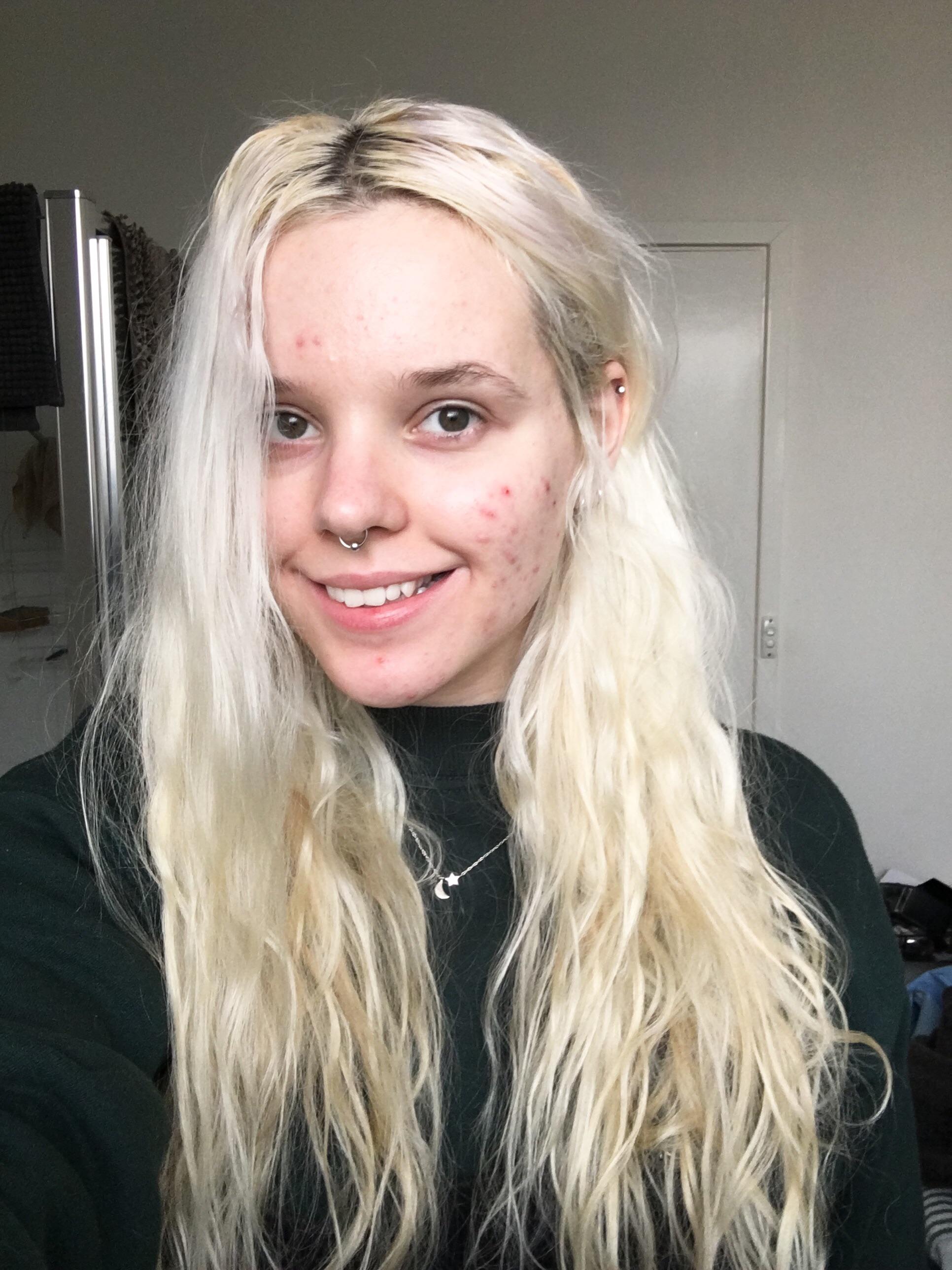 Acne is normal and fine and unrealistic beauty standards r stoopid 🙃 | Scrolller