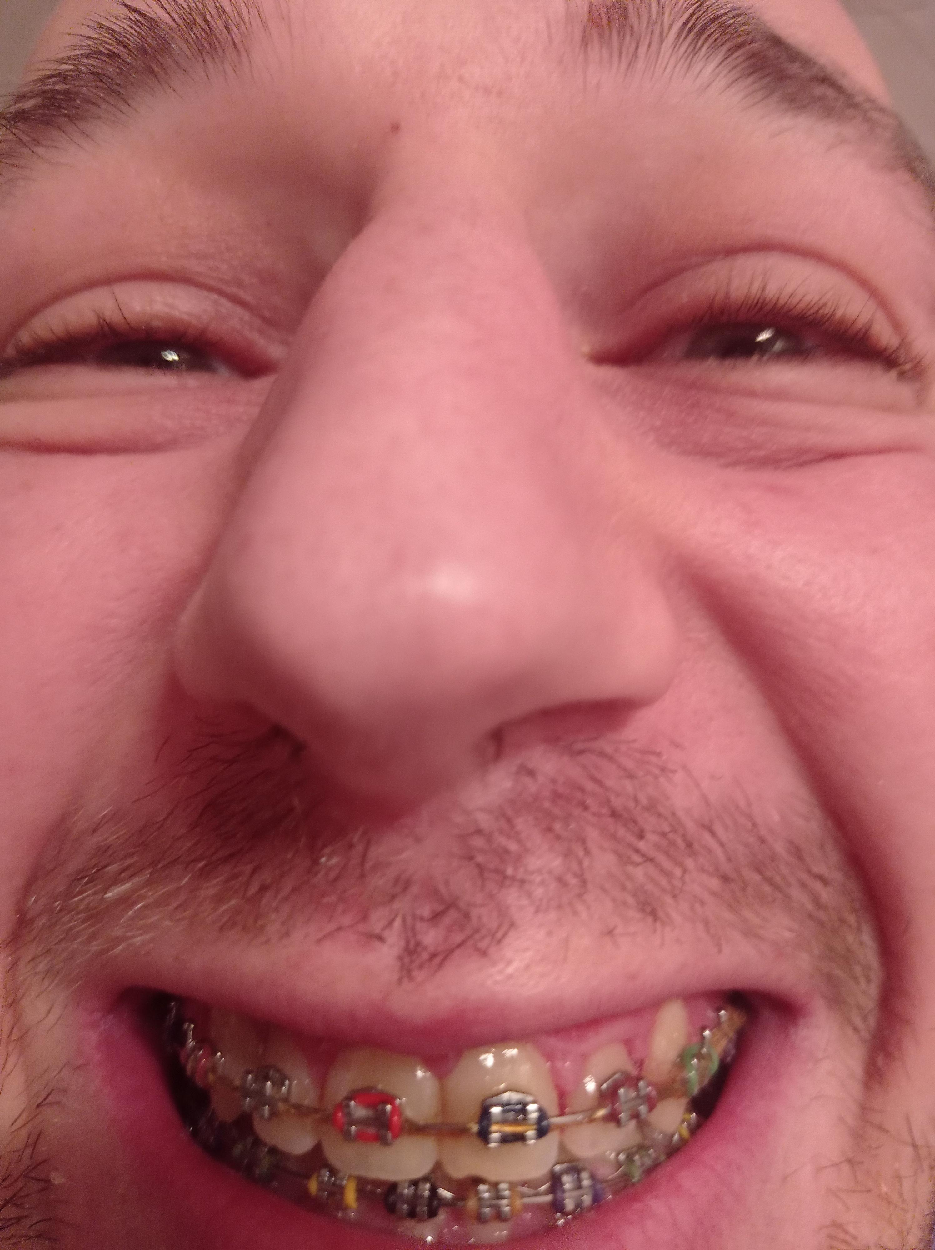 And Braces Photo Scrolller