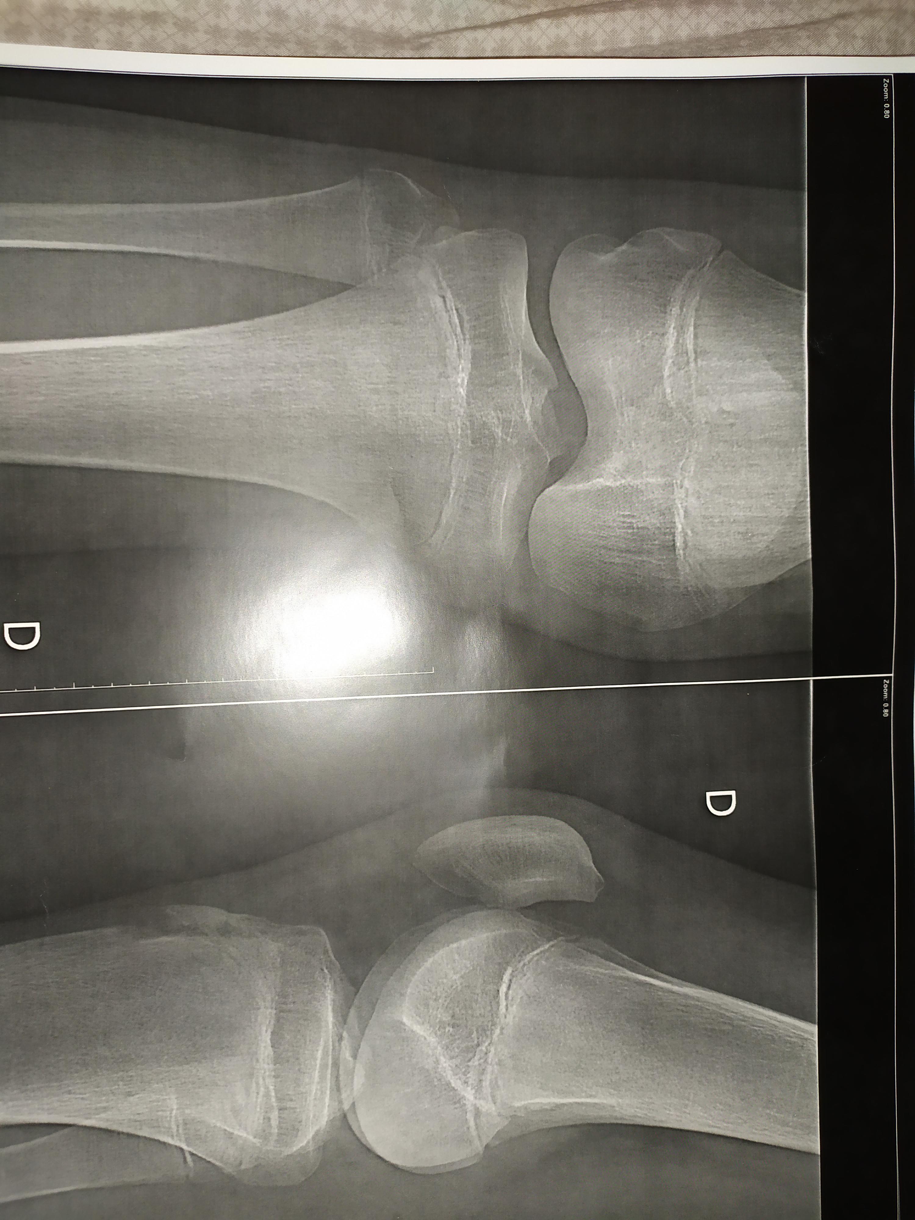 Are My Growth Plates Closed Scrolller