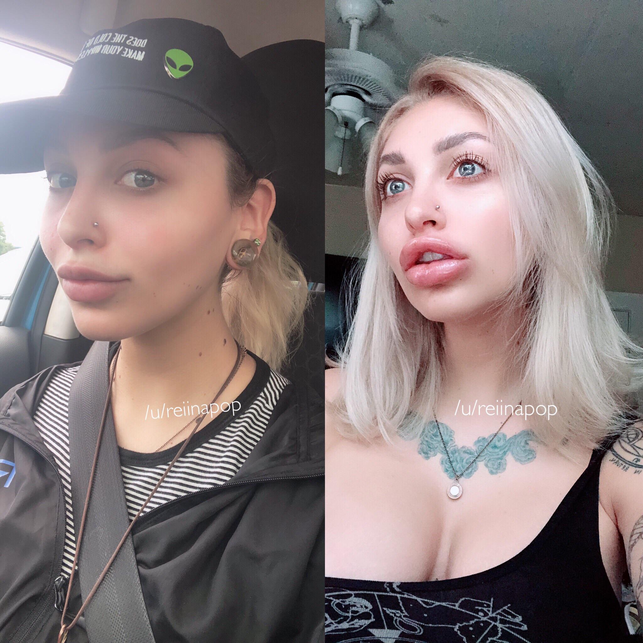 before/after freshly bleached hair + 1 syringe juvederm ultra plus ️ | Scrolller
