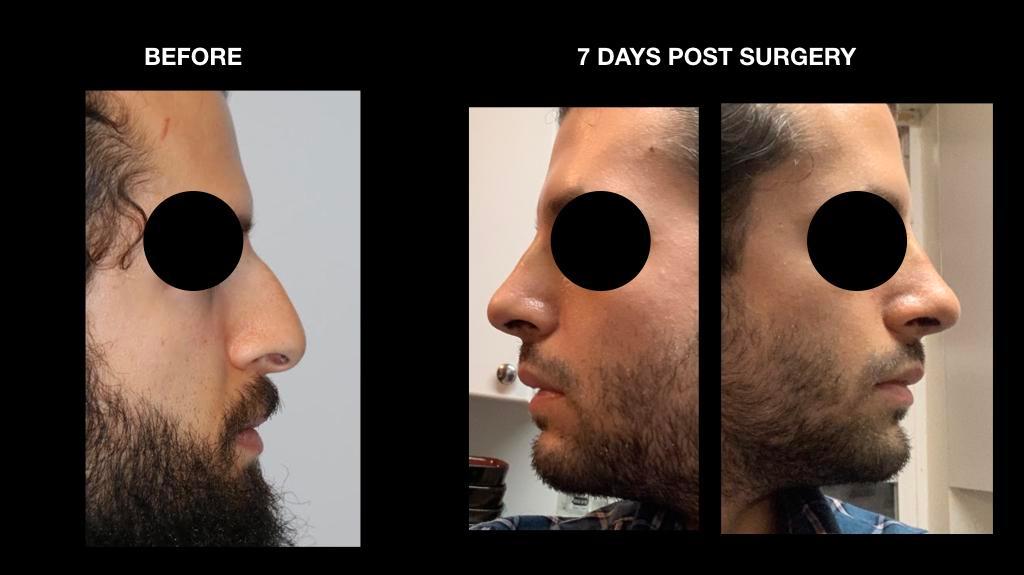Before & After - 32 Male Rhinoplasty - 7 Days Post-Op | Scrolller