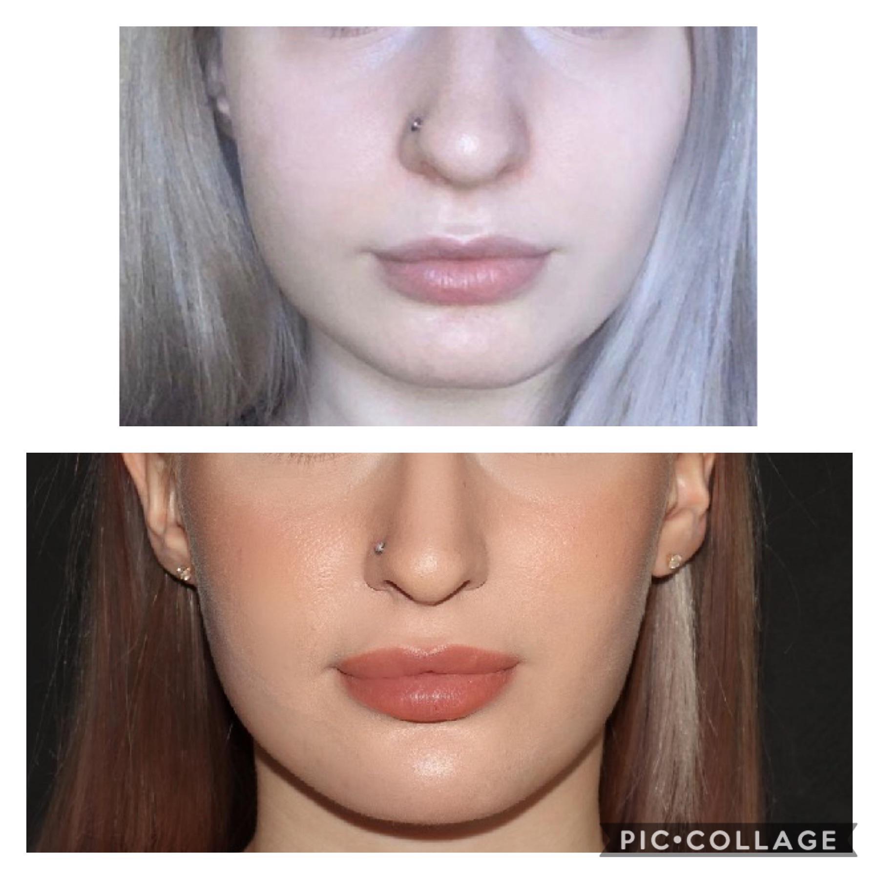 BEFORE AND AFTER LIP+NOSE+CHIN+JAWLINE FILLER | Scrolller