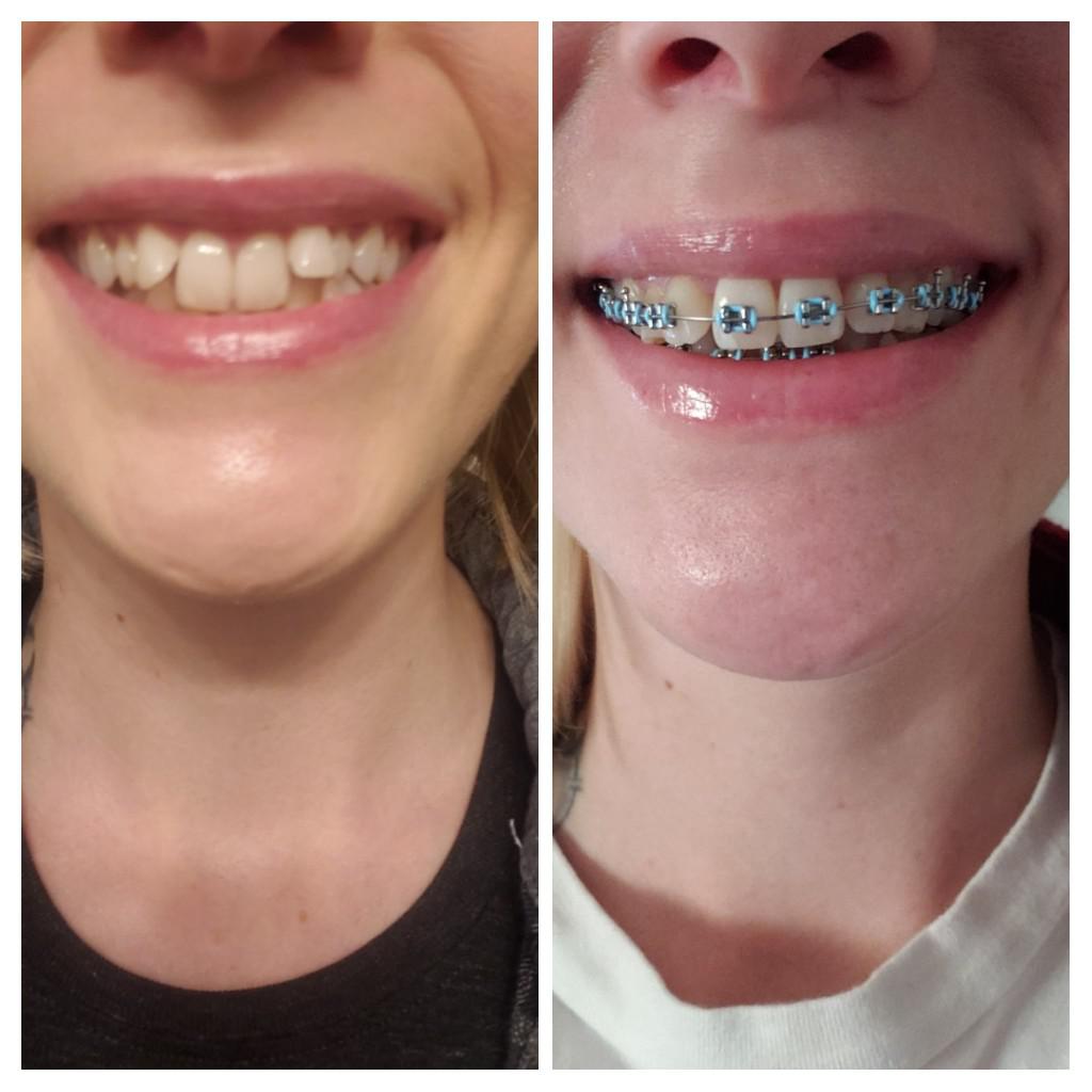 Before and now after almost 3 months | Scrolller
