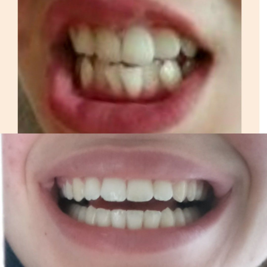 Before vs after braces for 11 months! | Scrolller