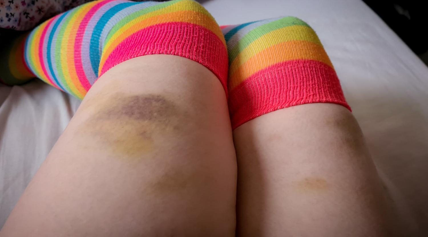 Bruise Update Following Our Heavy Caning Session | Scrolller