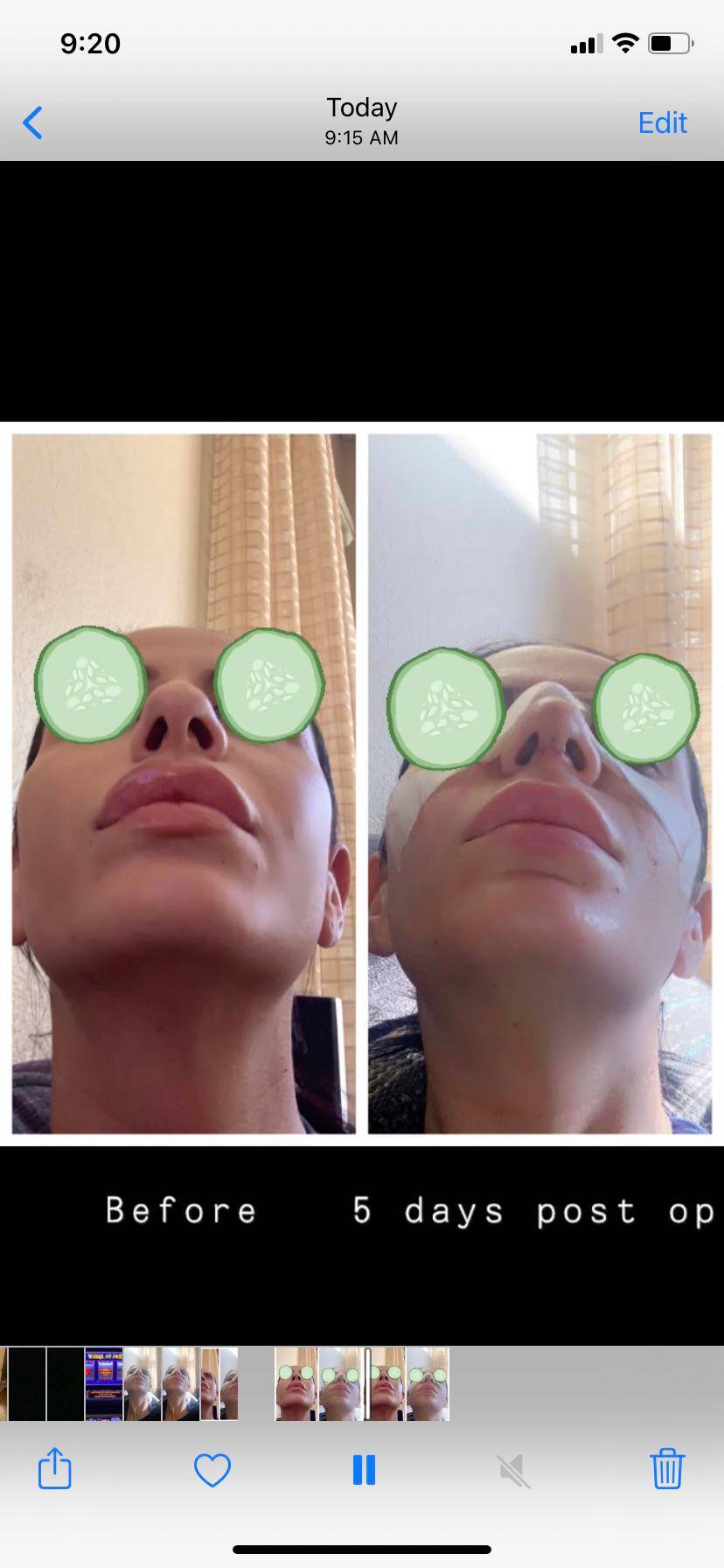 Bulbous tip 5 days post op | Scrolller