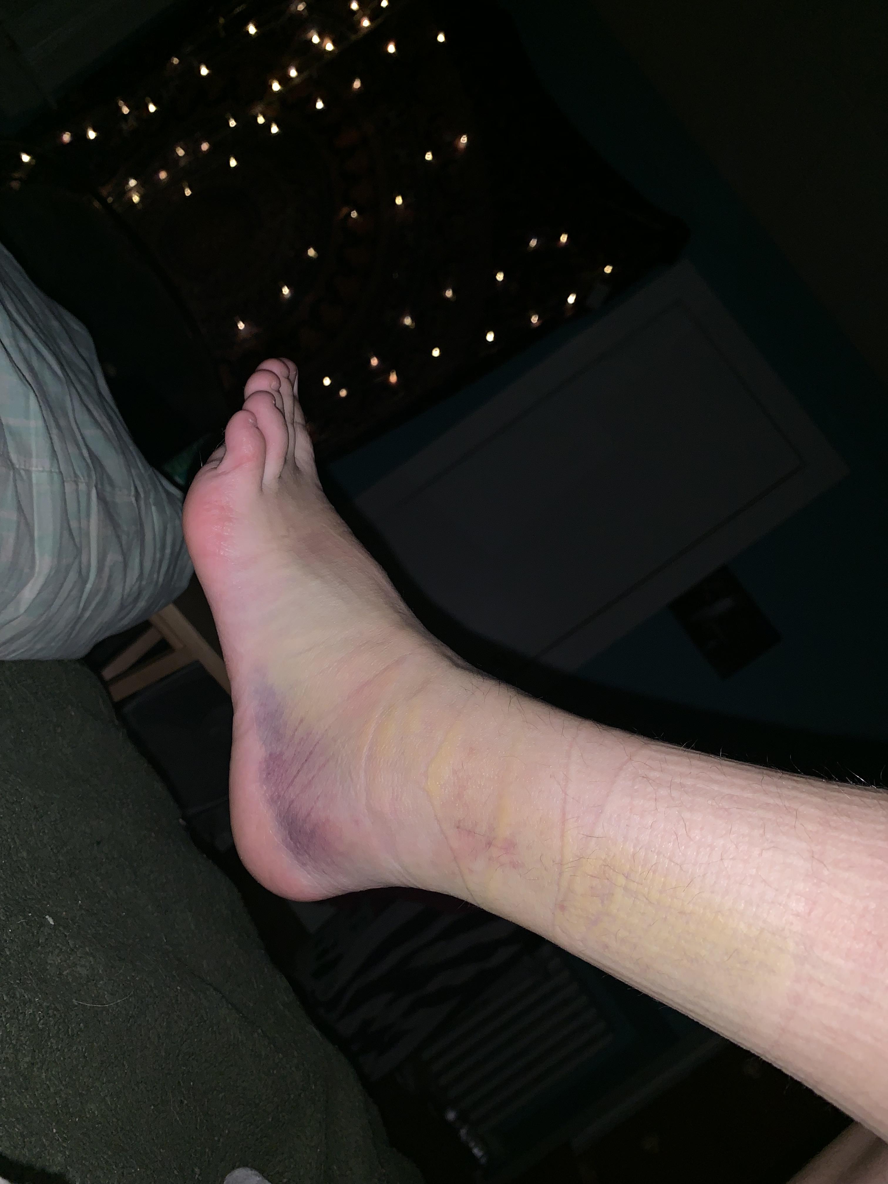 Colorful sprained ankle I recently got over & felt this was a good place for some of my pictures ...