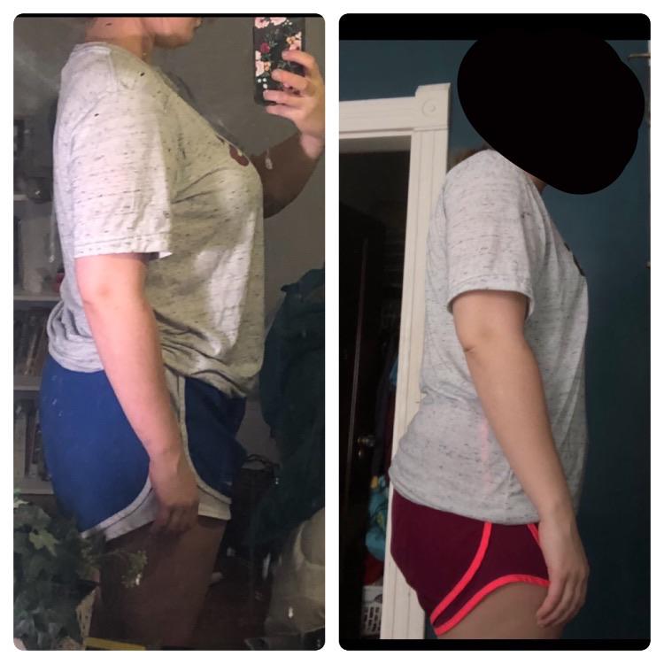 Comparison photo! 2 weeks post op | Scrolller