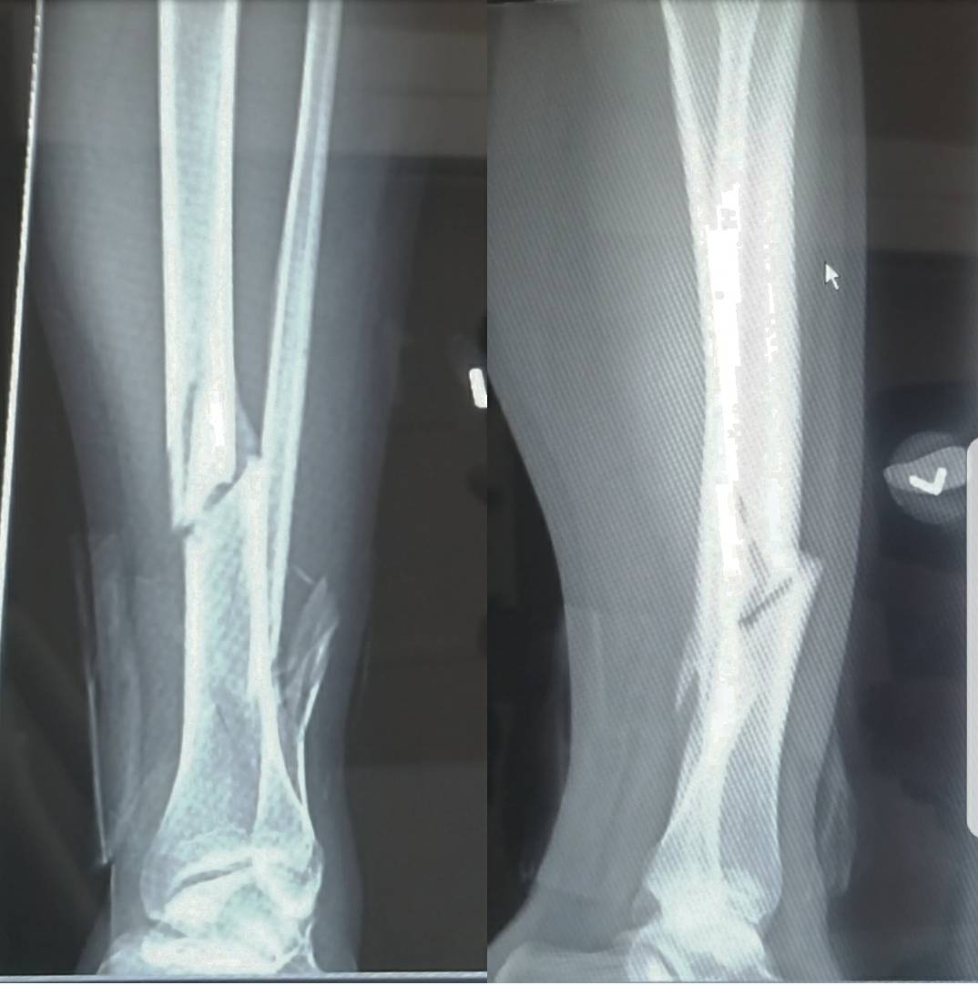 Compound tibia/fibula fracture | Scrolller