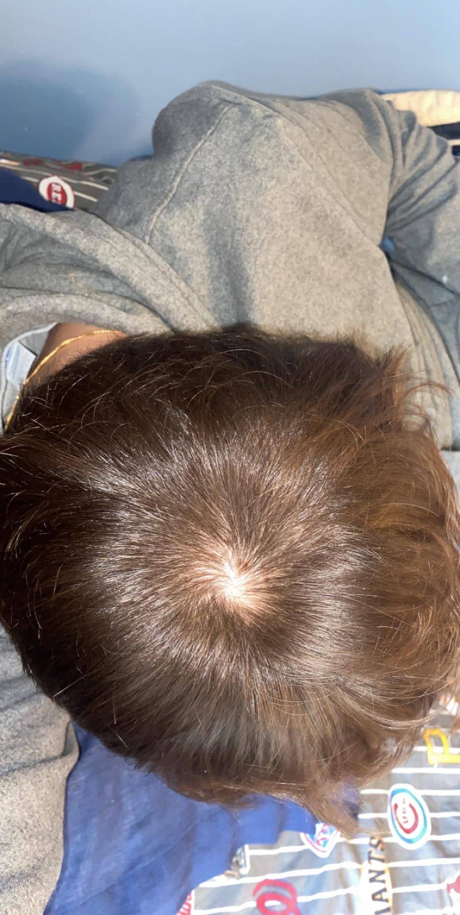 Cowlick or Balding | Scrolller