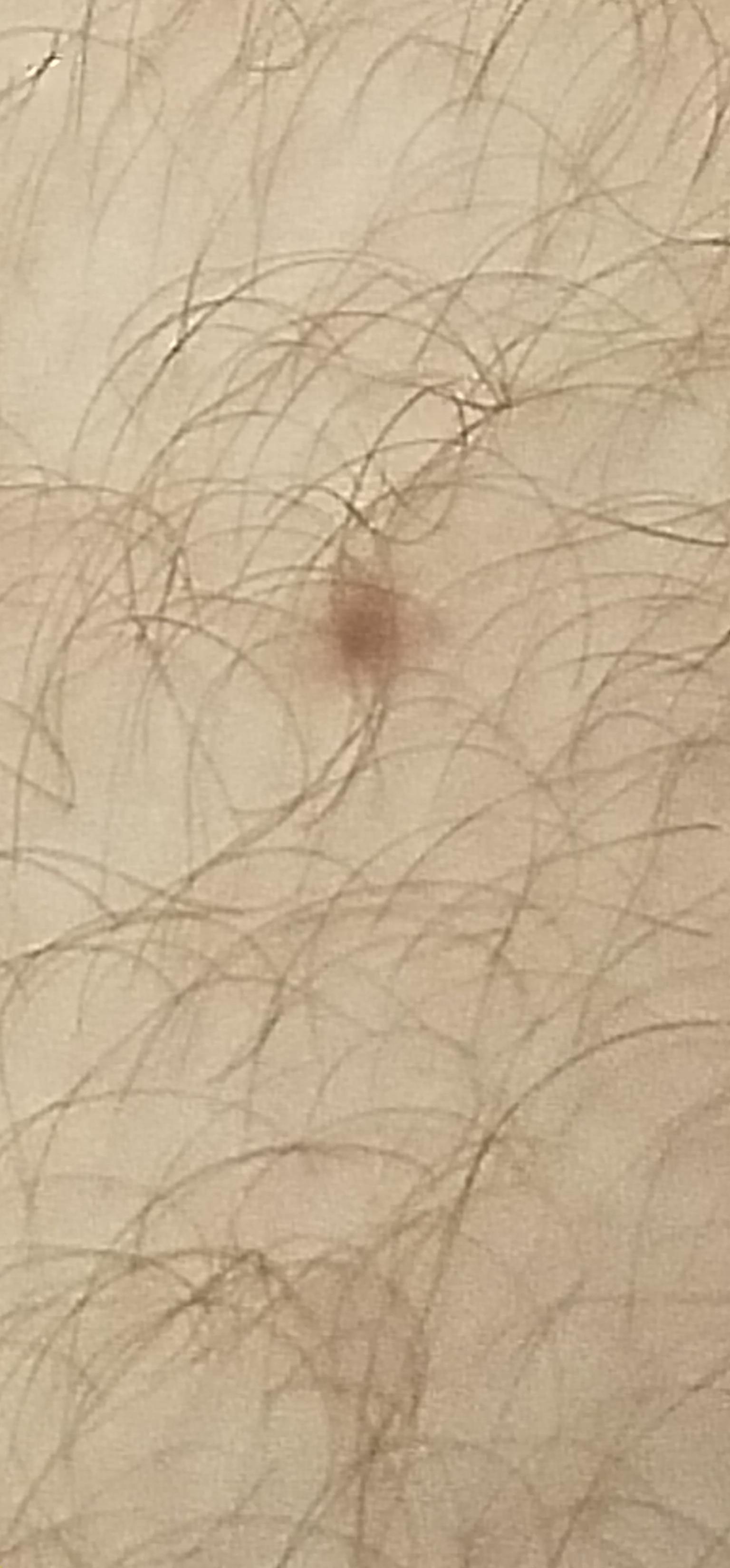 Does this mole look normal?? | Scrolller