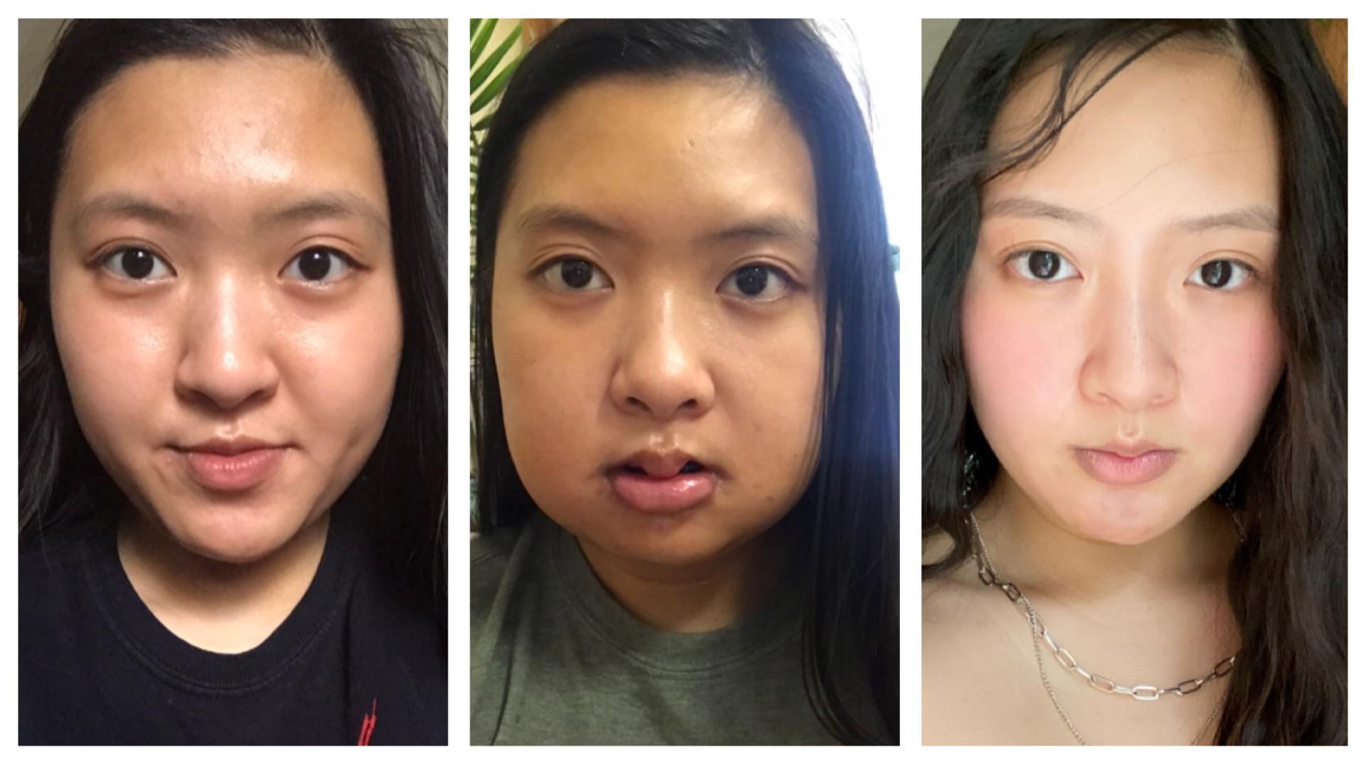 Double Jaw Surgery to Fix Underbite. Before, 5 days post op, 2 years post op. | Scrolller