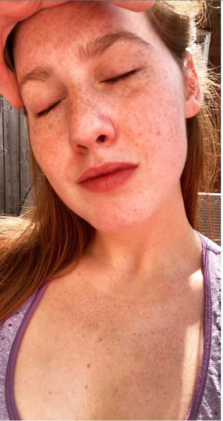 Excessive freckles | Scrolller