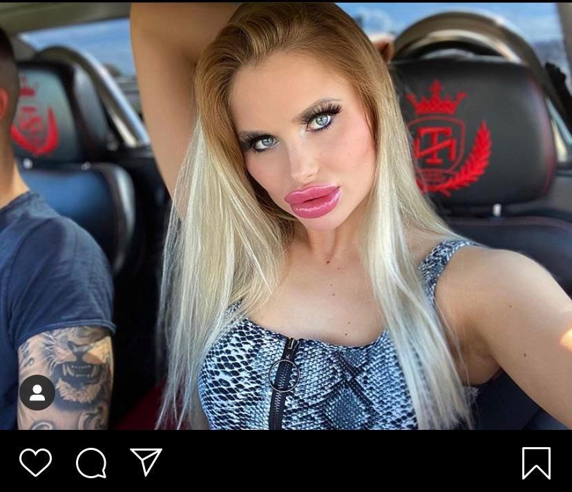 Extreme lip fillers | Scrolller