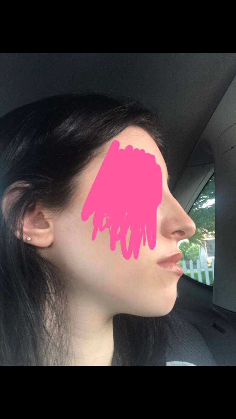 F19 Do I have a receding chin? | Scrolller