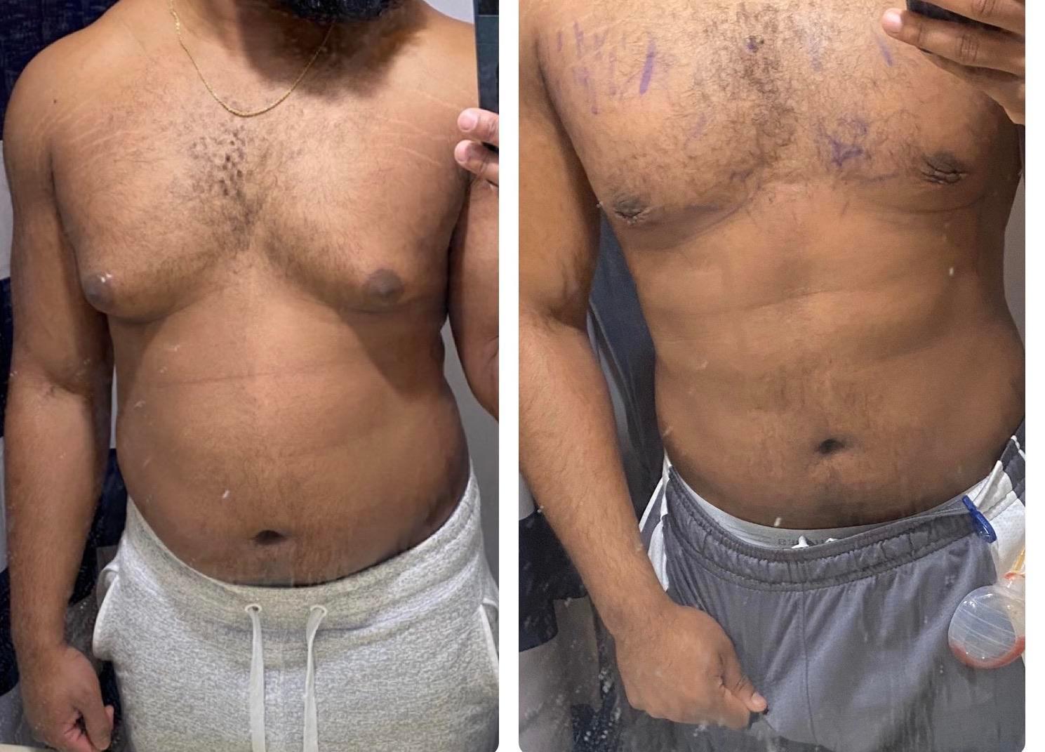 First before vs. after (1 week post op) | Scrolller