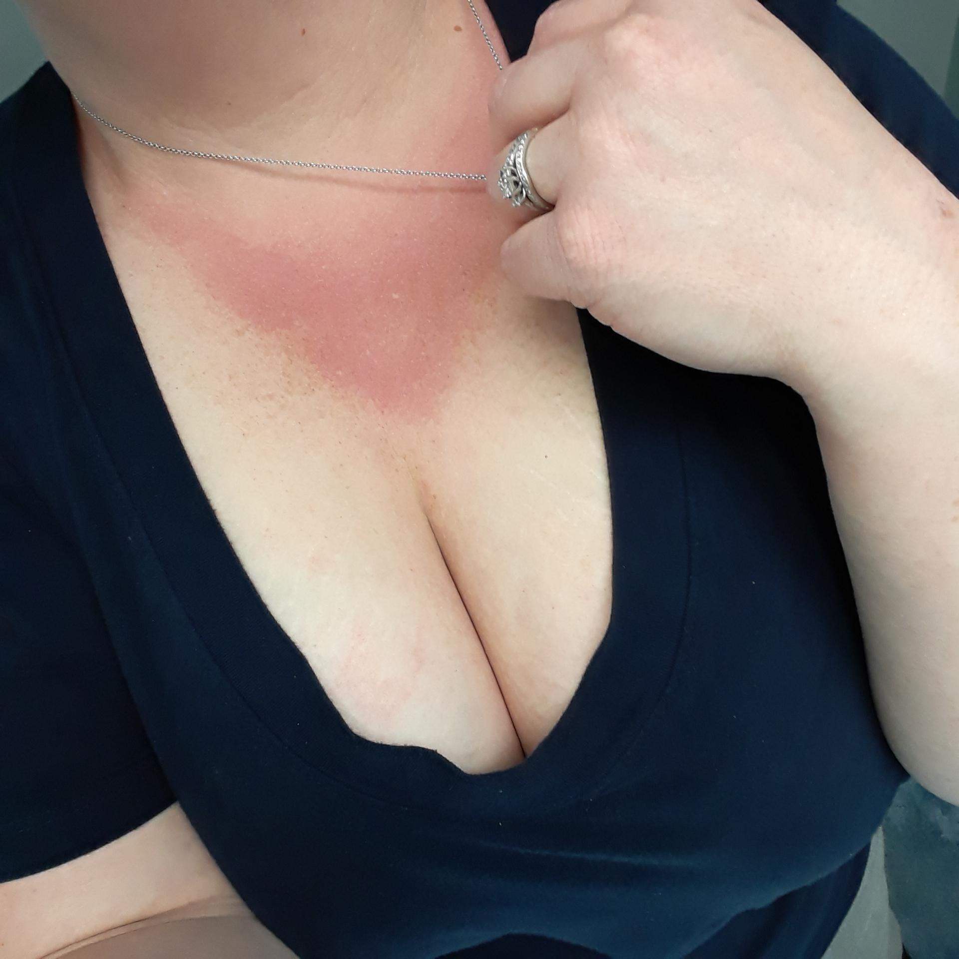 First sunburn of the year 😉 | Scrolller