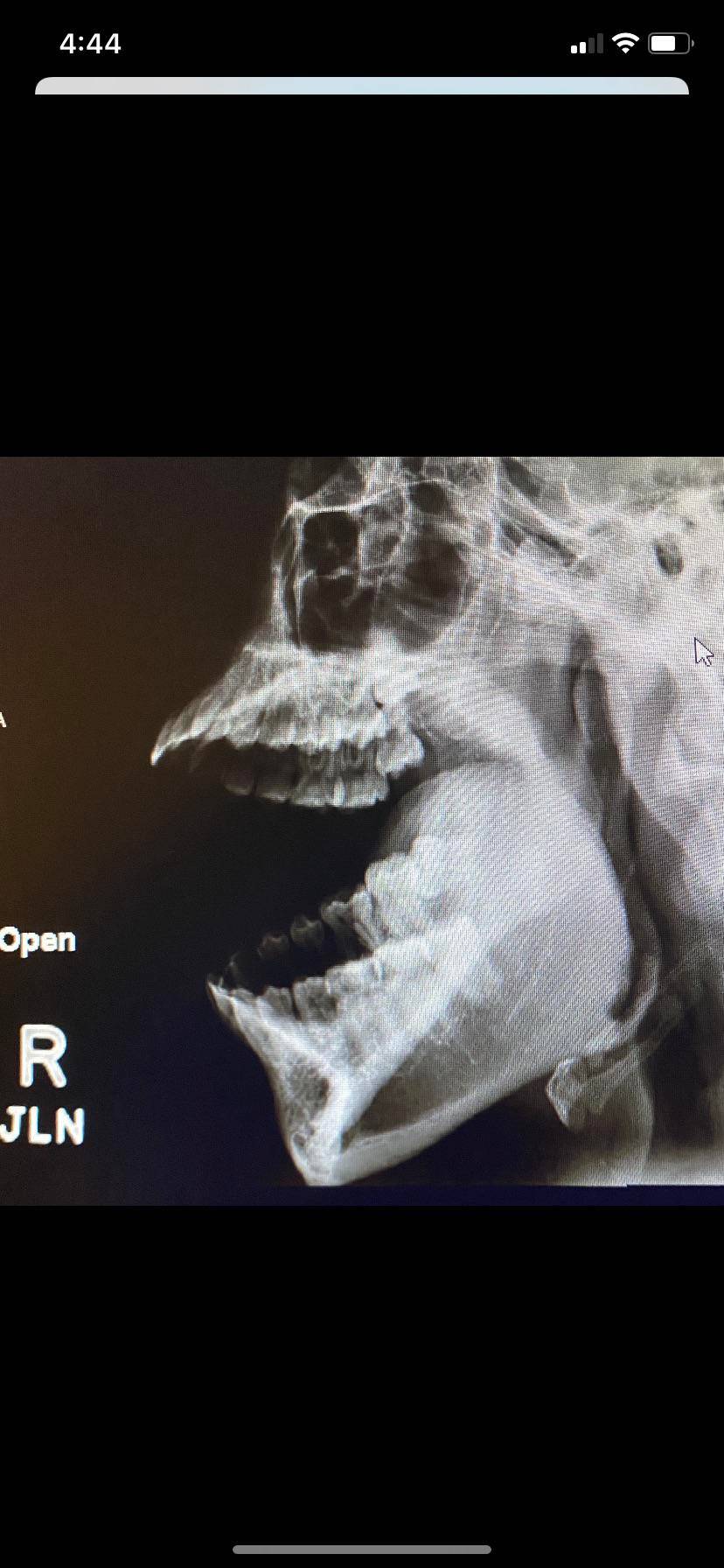 First time doing TMJ xray open and closed | Scrolller