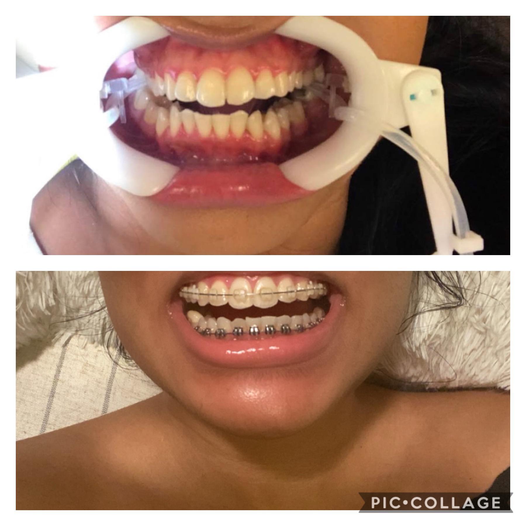 Found a before and after picture of my teeth! Getting braces was the best decision I ever made ...