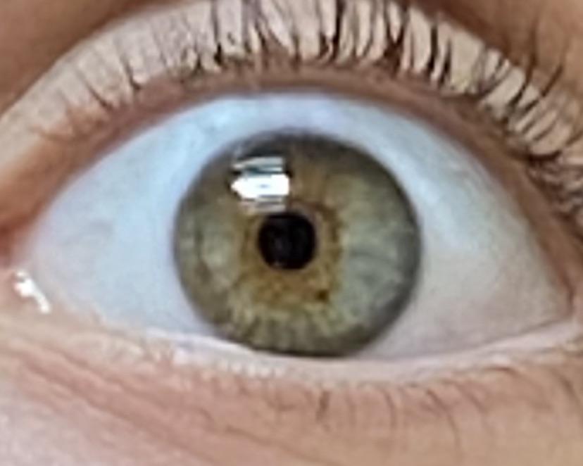 Grey/brown. Is this common for central heterochromia? | Scrolller