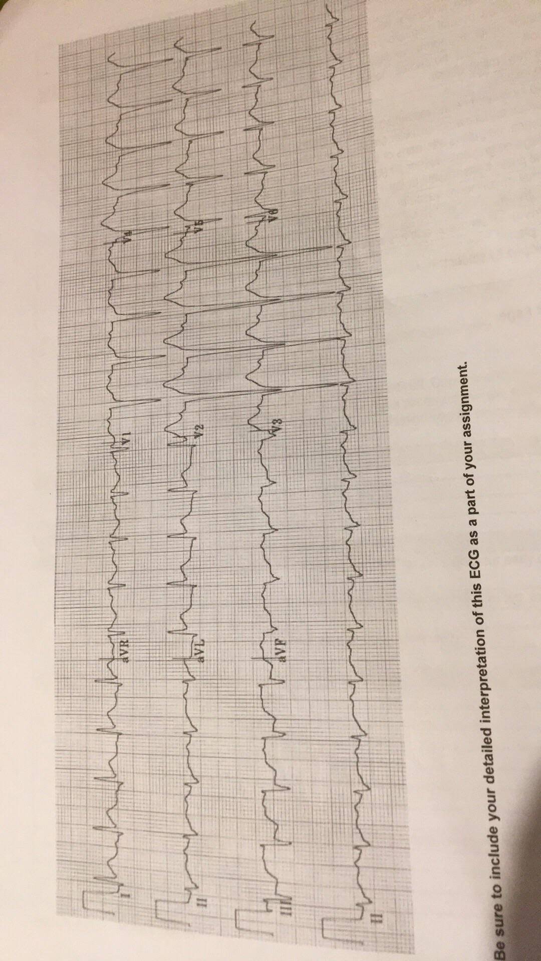 Can anyone help a student with this ECG interpretation? Please | Scrolller