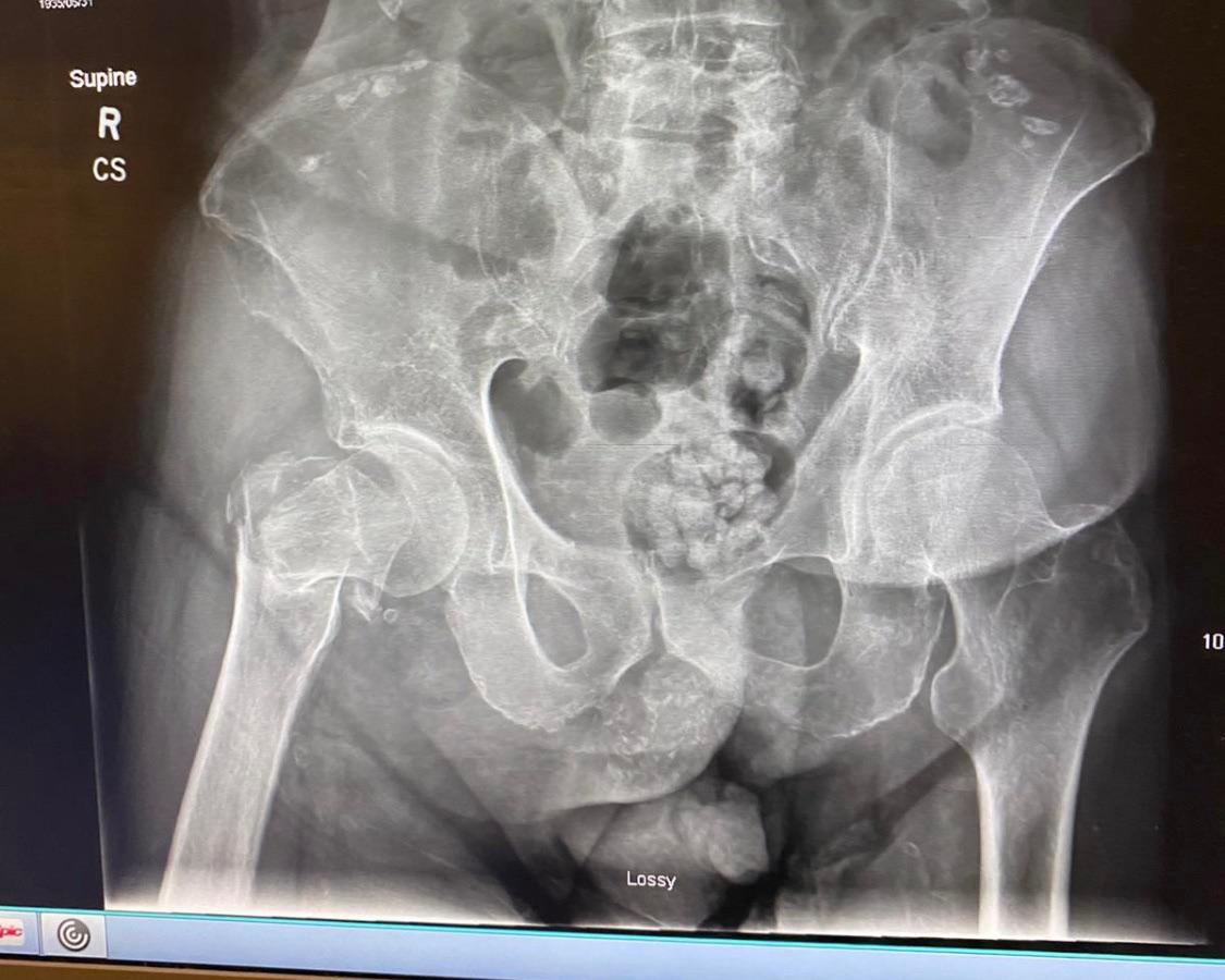 Help identifying what type of hip fracture this is | Scrolller