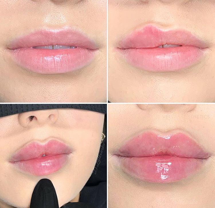 How are the ”Russian style” lips injected? | Scrolller