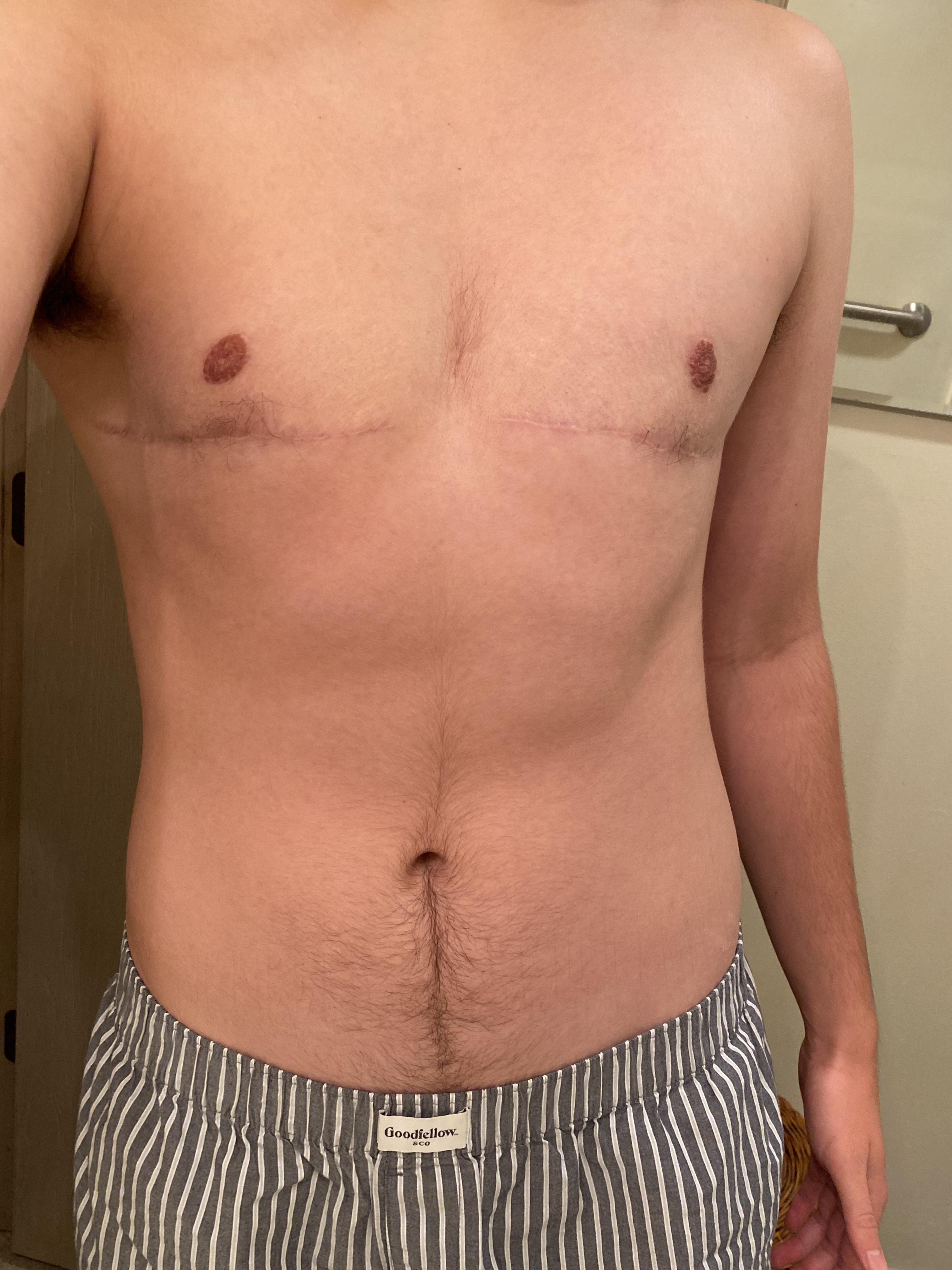 I'm one year post-op! (Story and reflections in the comments below). | Scrolller