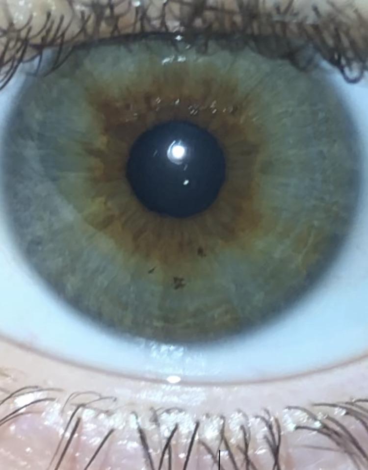 Is this Central Heterochromia, green, or hazel? | Scrolller